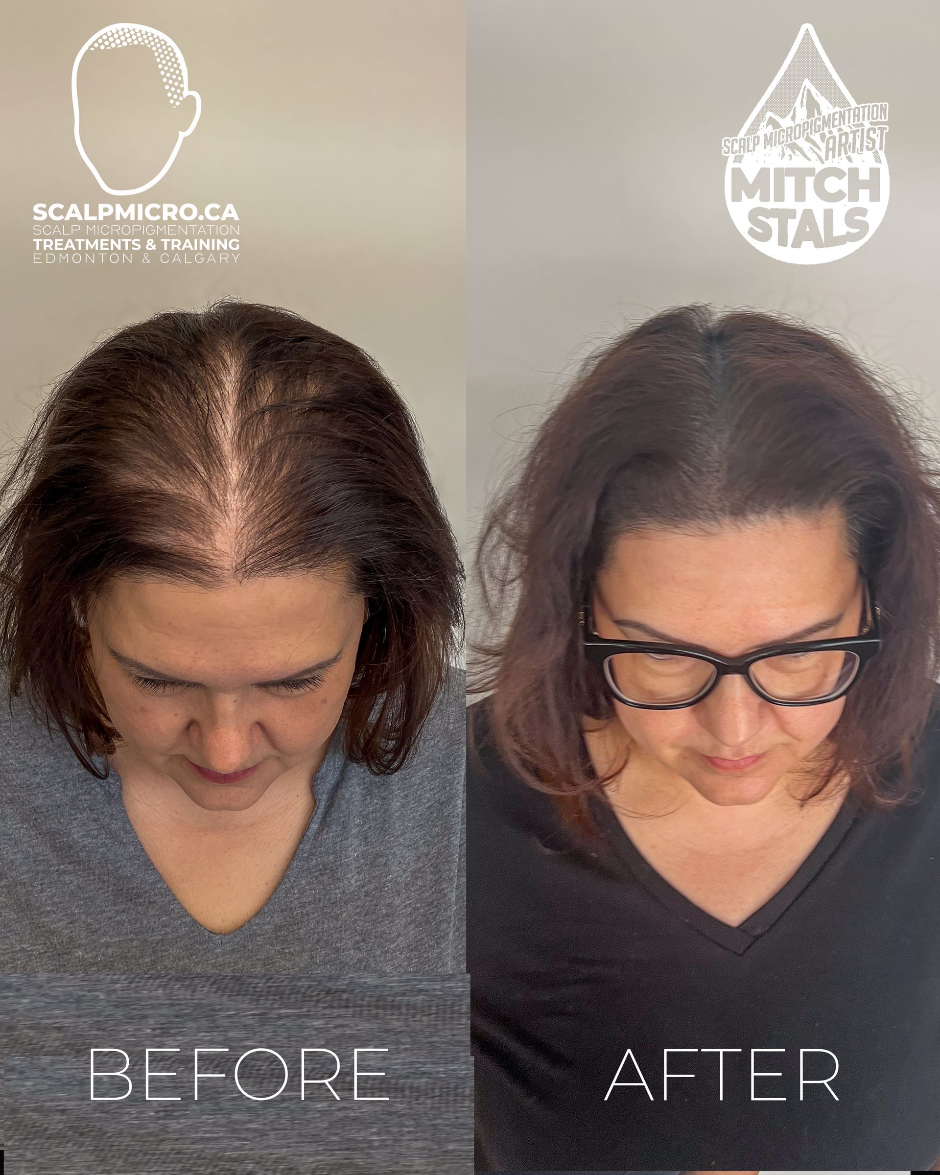 Scalp Micropigmentation Treatments | SMP Edmonton