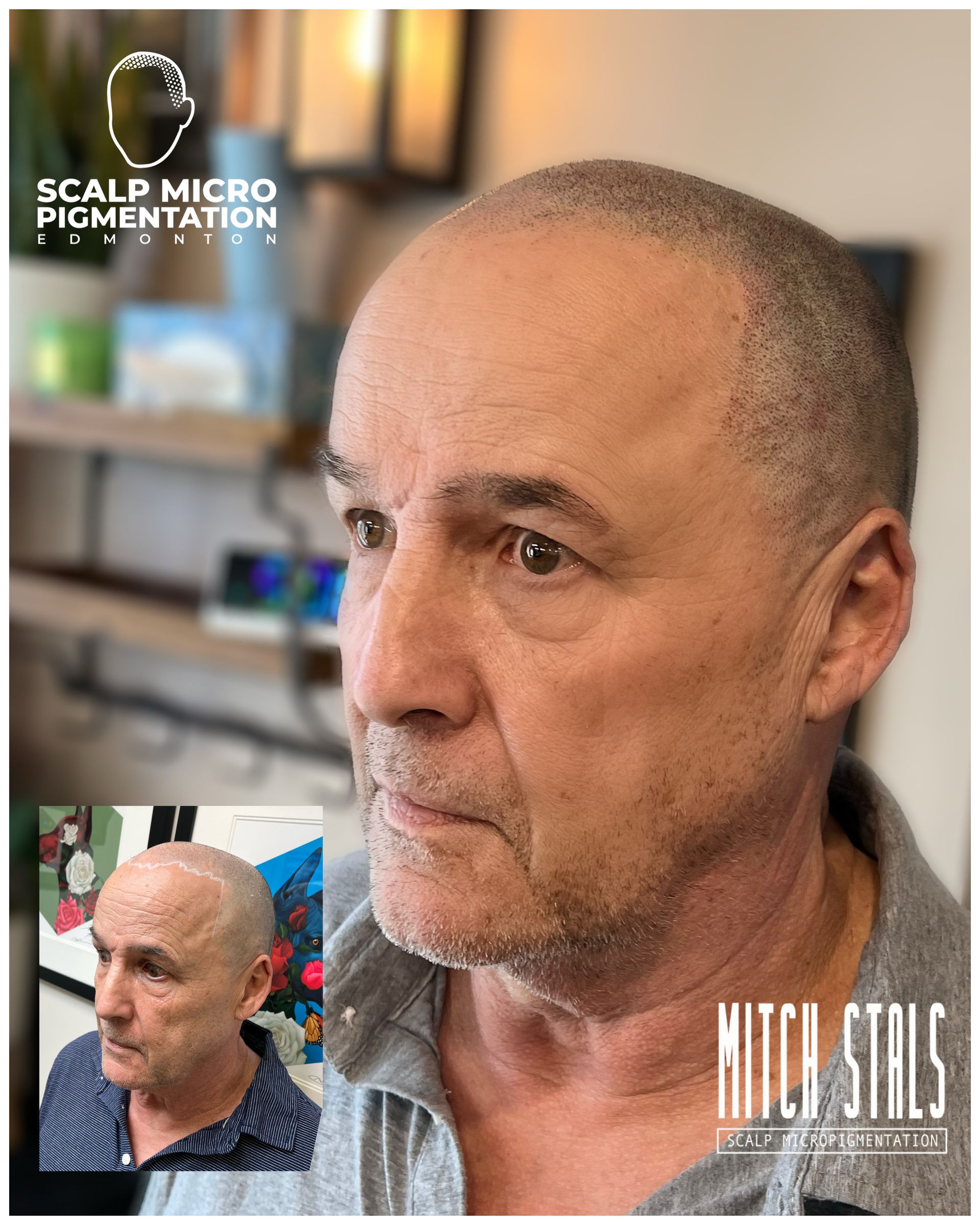 Before and After SMP Scalp micropigmentation