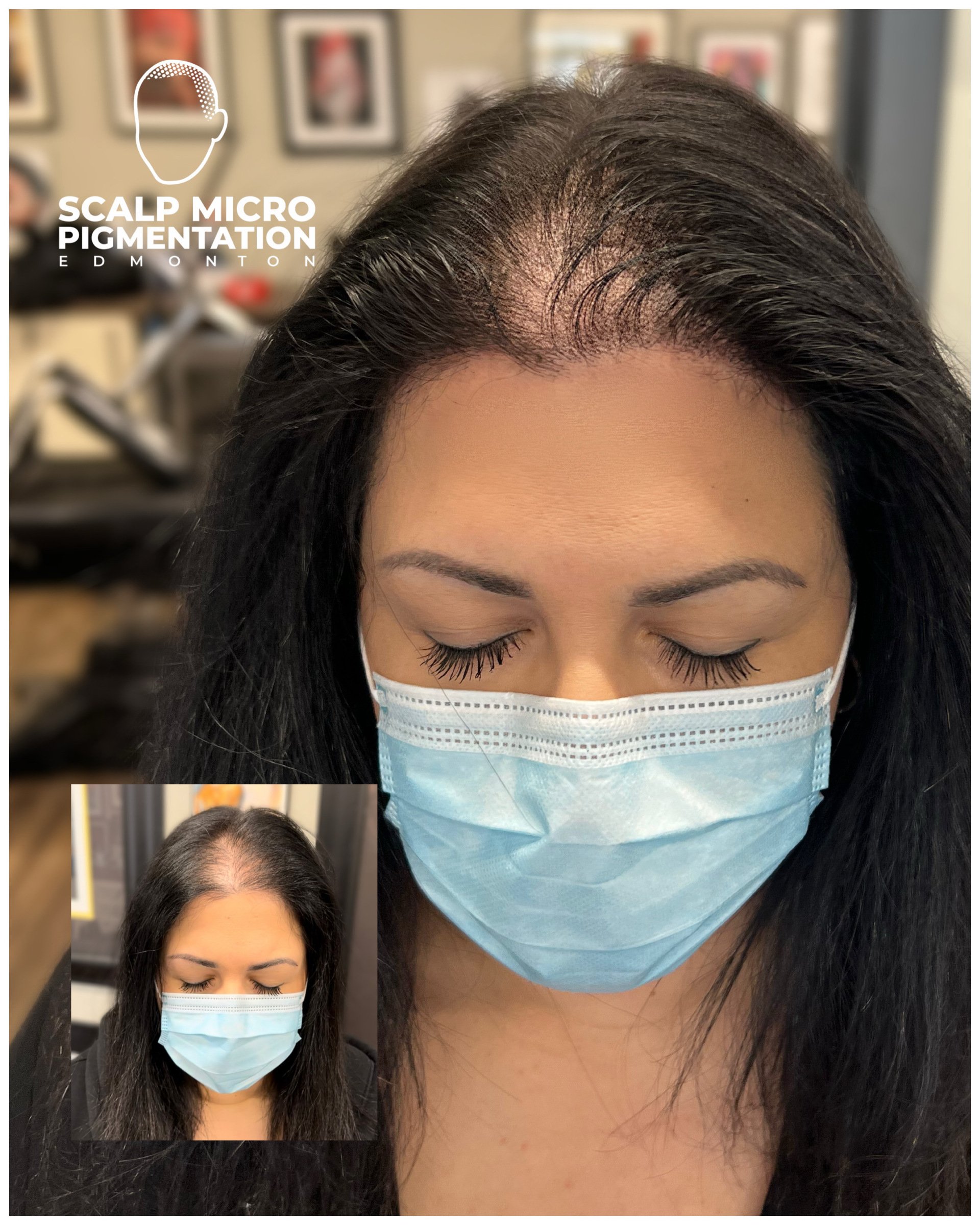 Female Scalp Micropigmentation Client Before & After Results