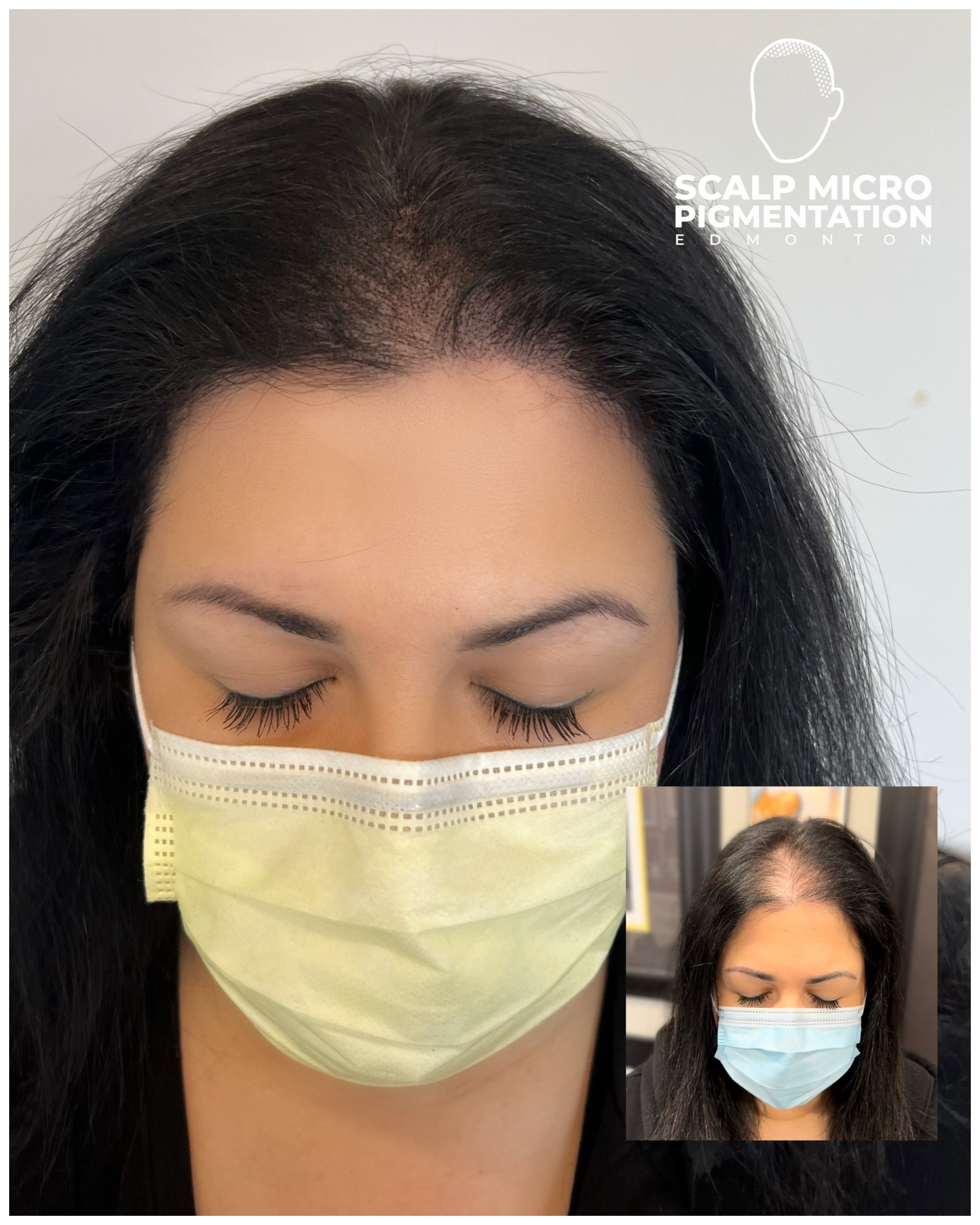 Female Scalp Micropigmentation Client Before & After Results
