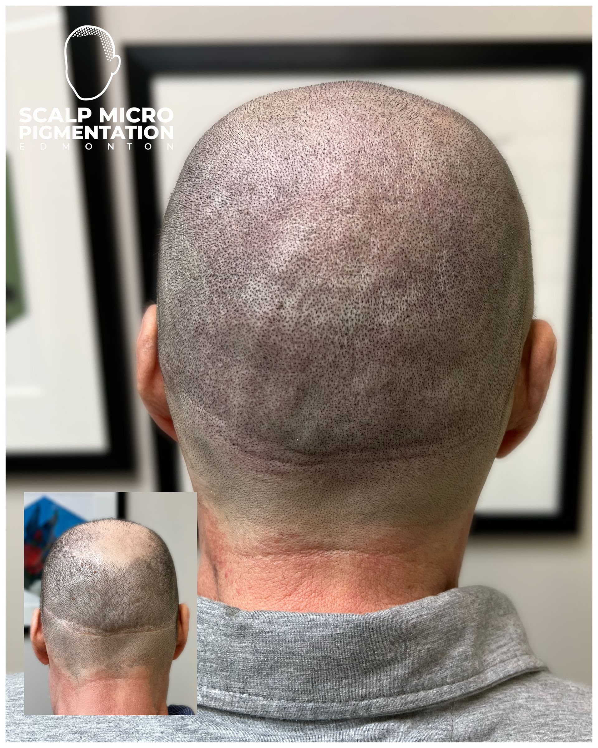 Scalp Micropigmentation Treatments | SMP Edmonton