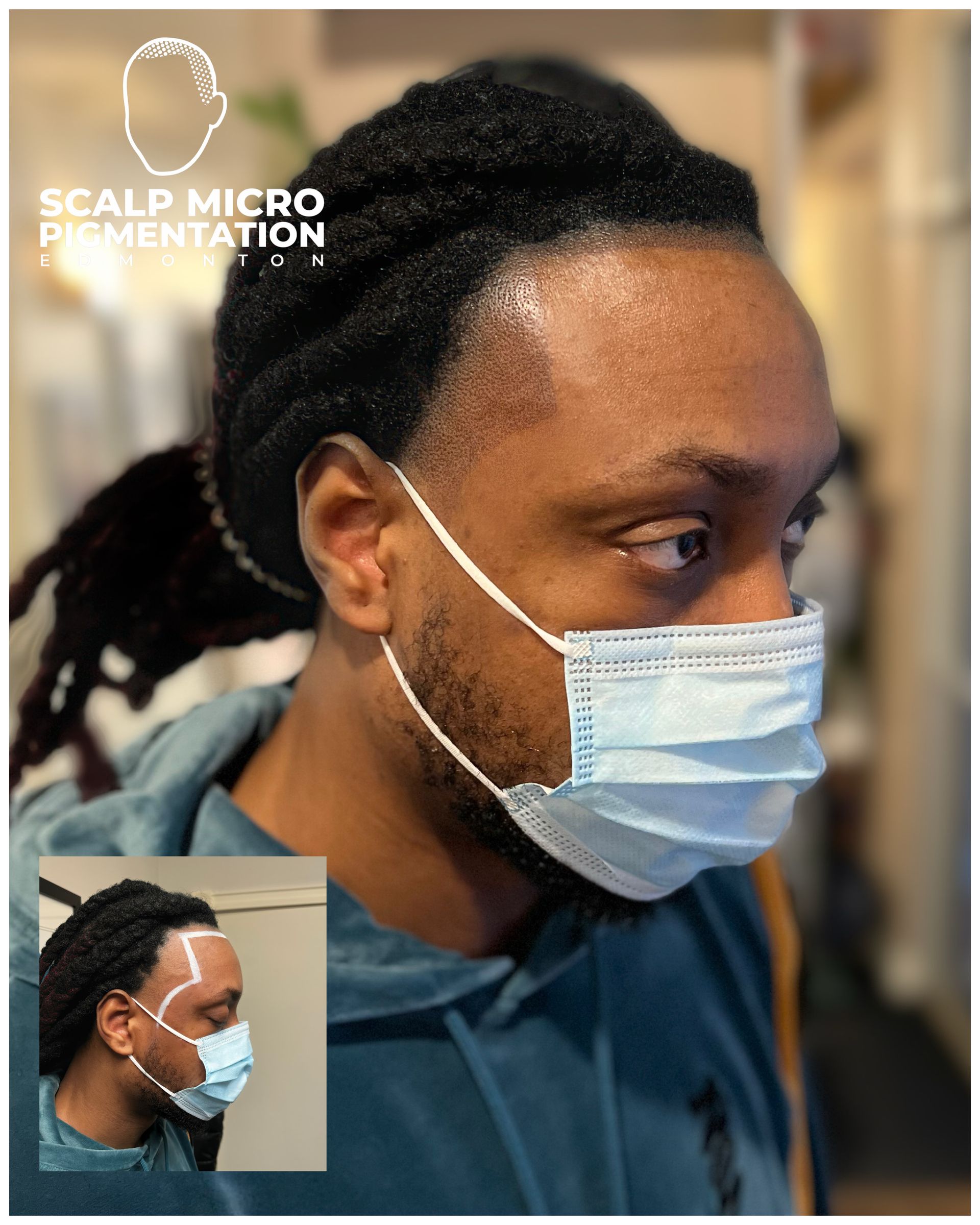 Before and After SMP Scalp micropigmentation