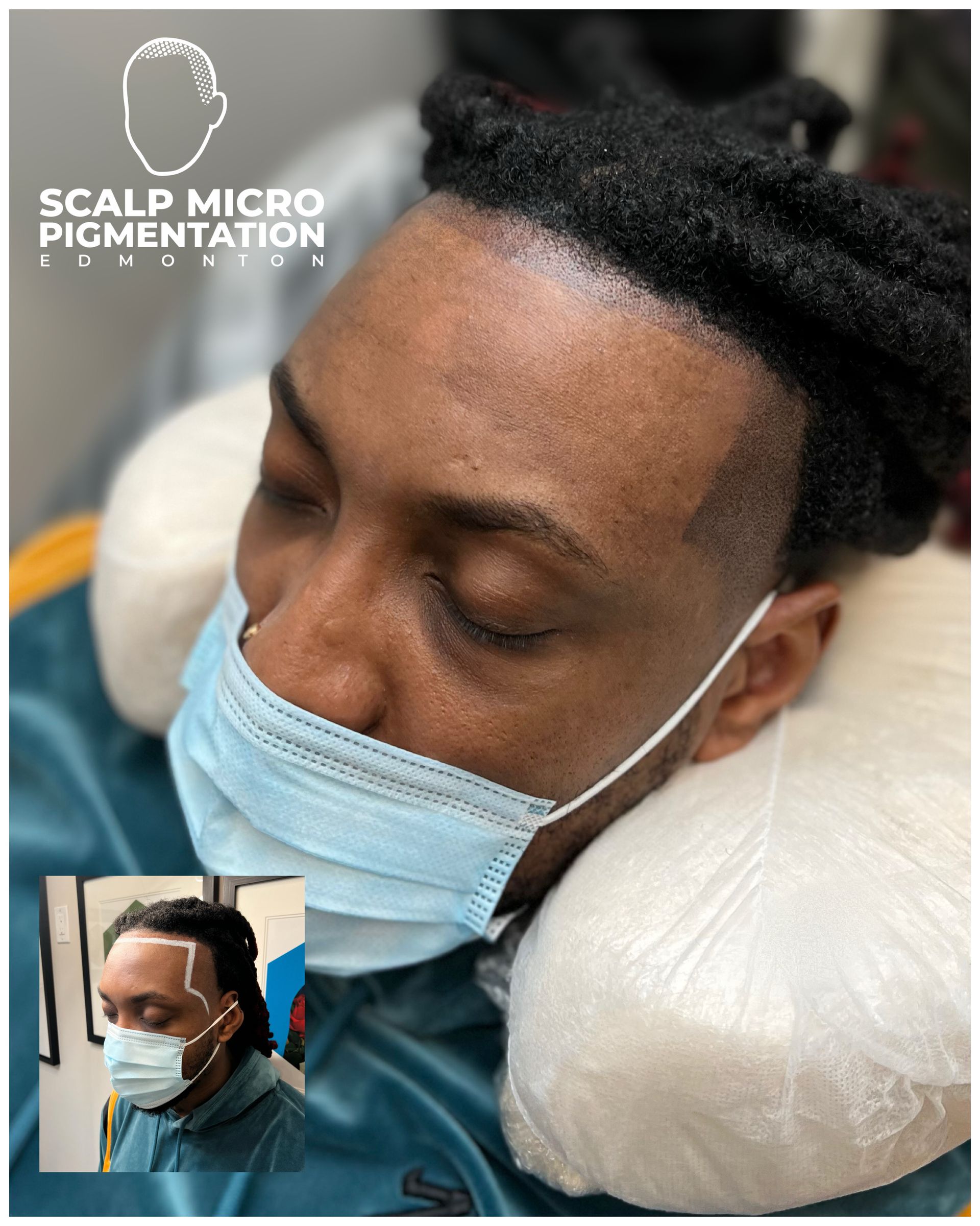 Before and After SMP Scalp micropigmentation