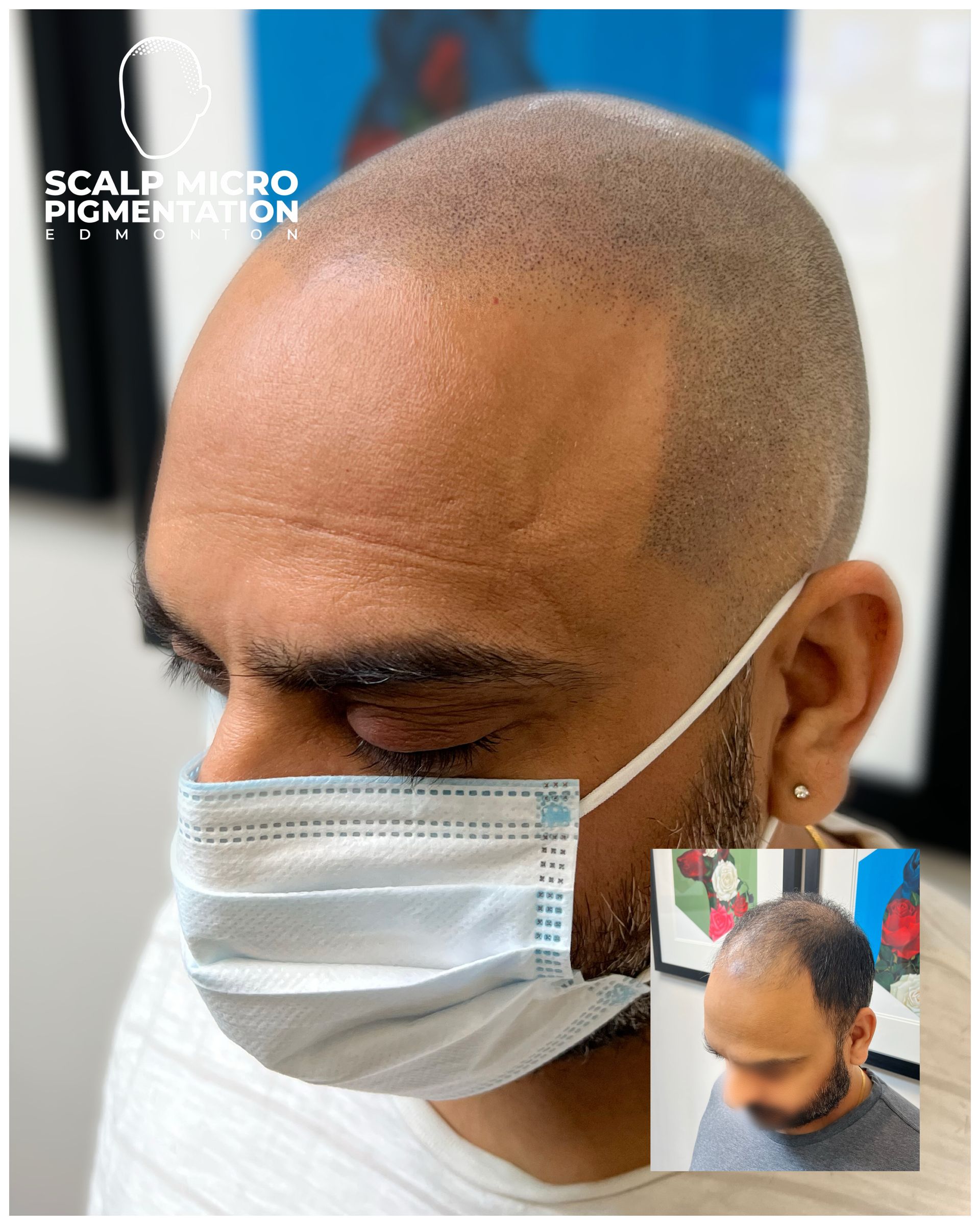Before and After SMP Scalp micropigmentation