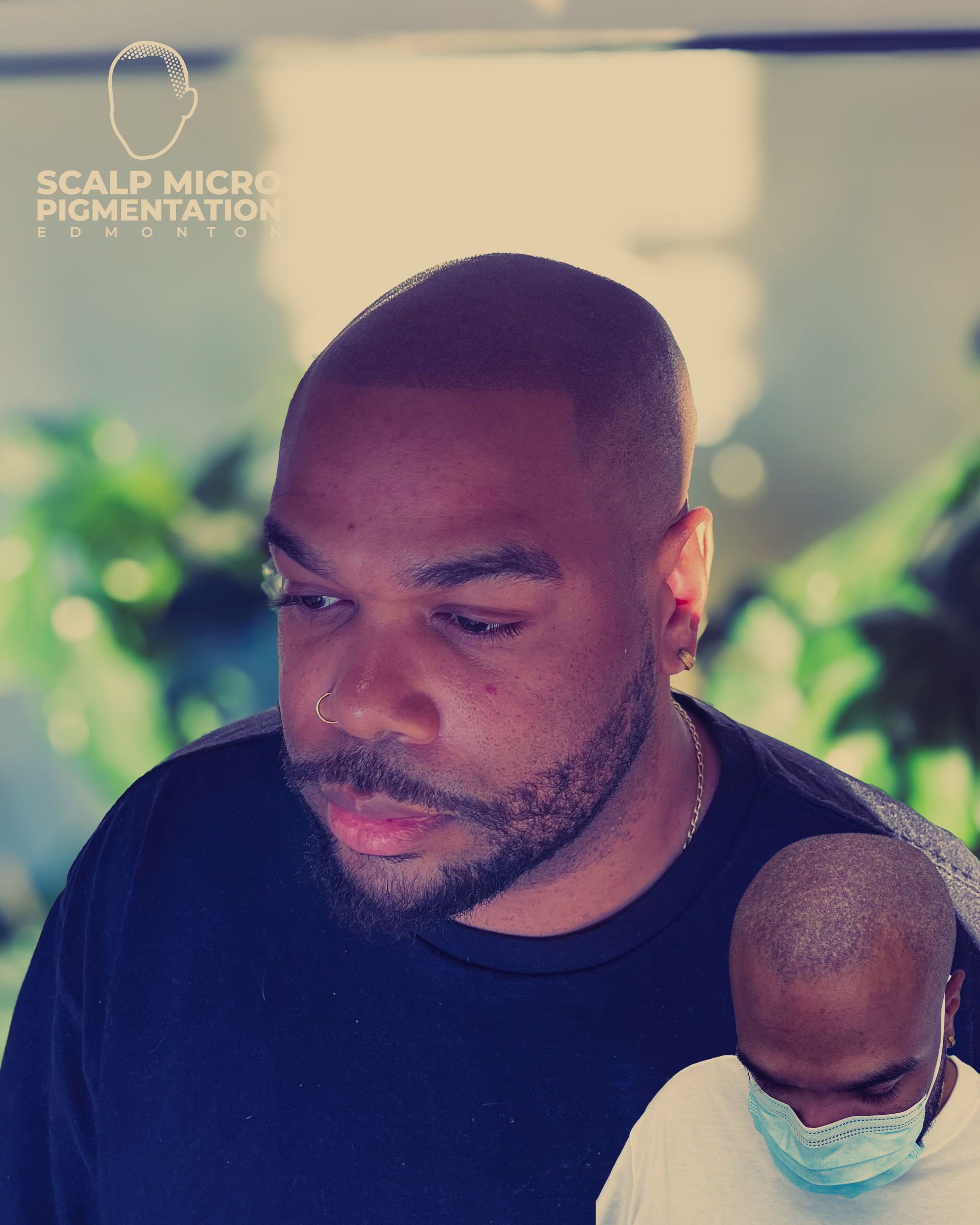 Scalp Micro Pigmentation Edmonton SMP - Hair Tattoo - Bald and Thinning ...