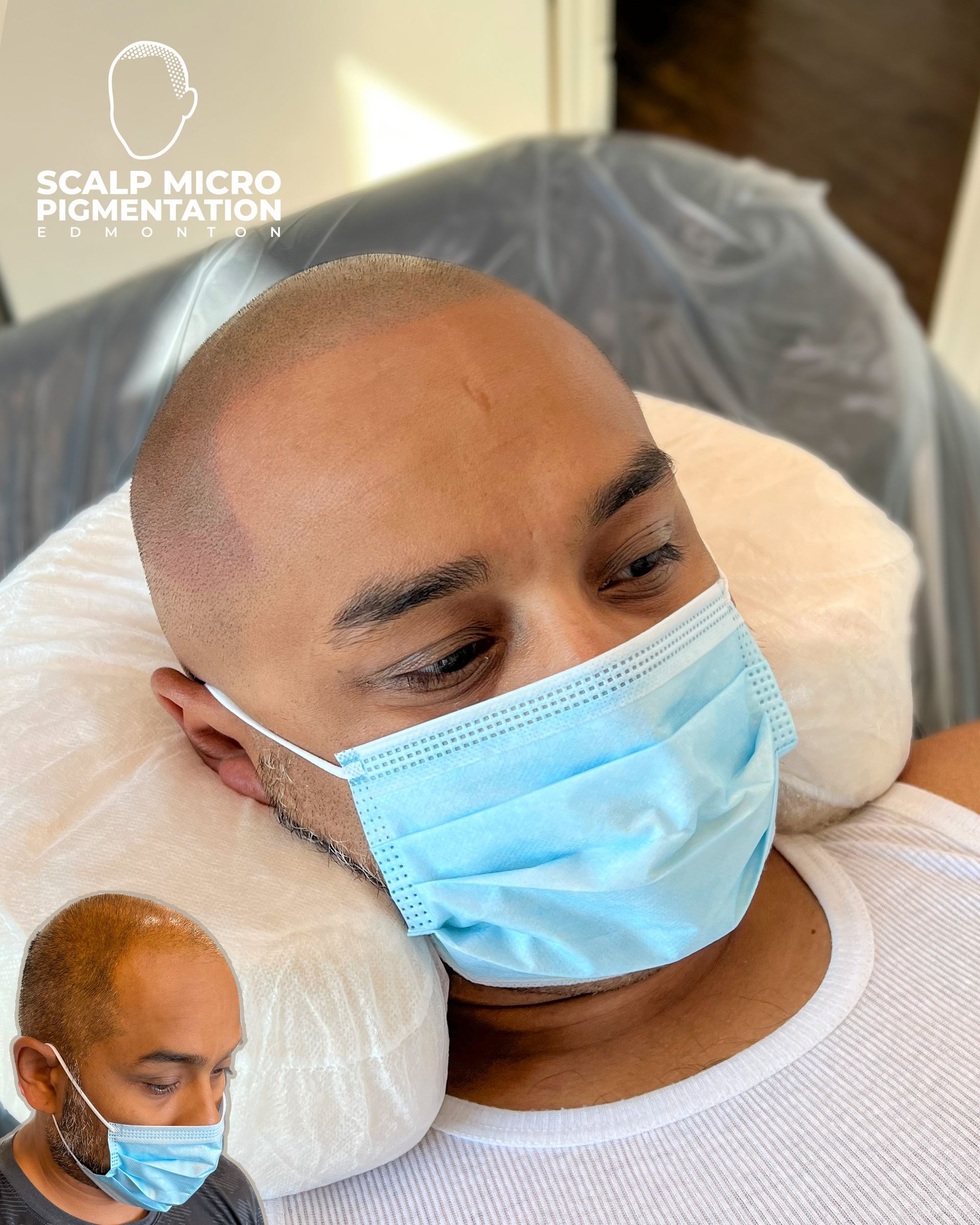 BEFORE & AFTER | Scalp Micropigmentation Edmonton