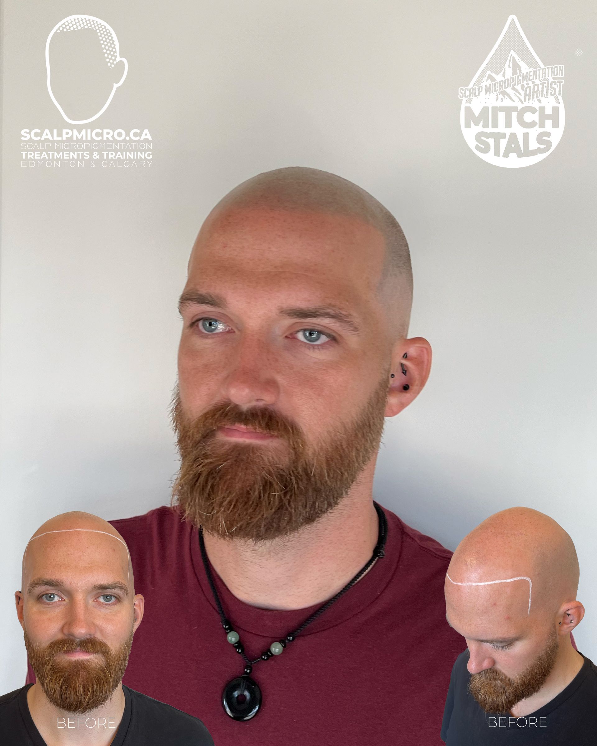 The Effectiveness of Scalp Micropigmentation (SMP) for Hiding Hair Loss ...