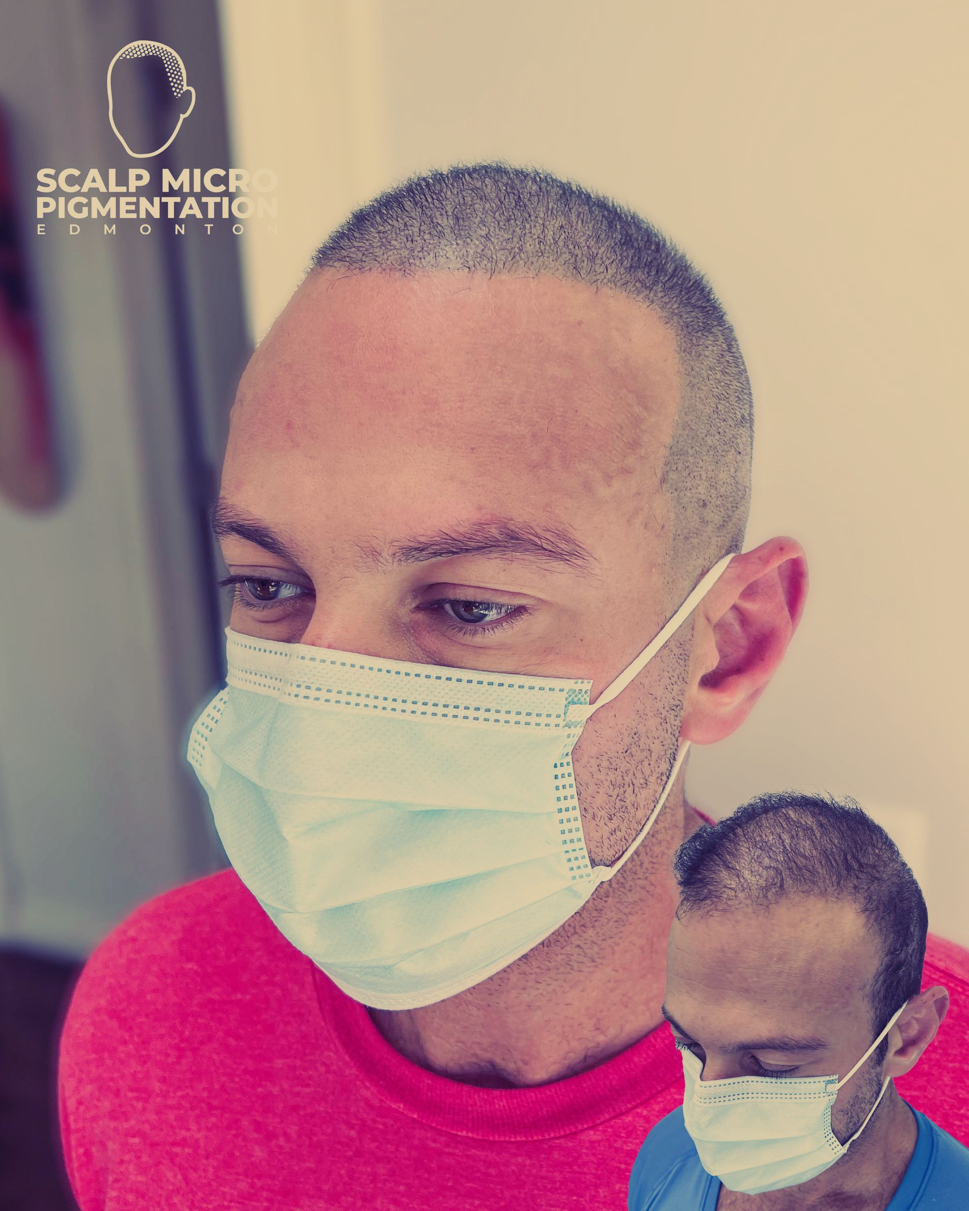 Scalp Micro Pigmentation Edmonton SMP - Hair Tattoo - Bald and Thinning ...