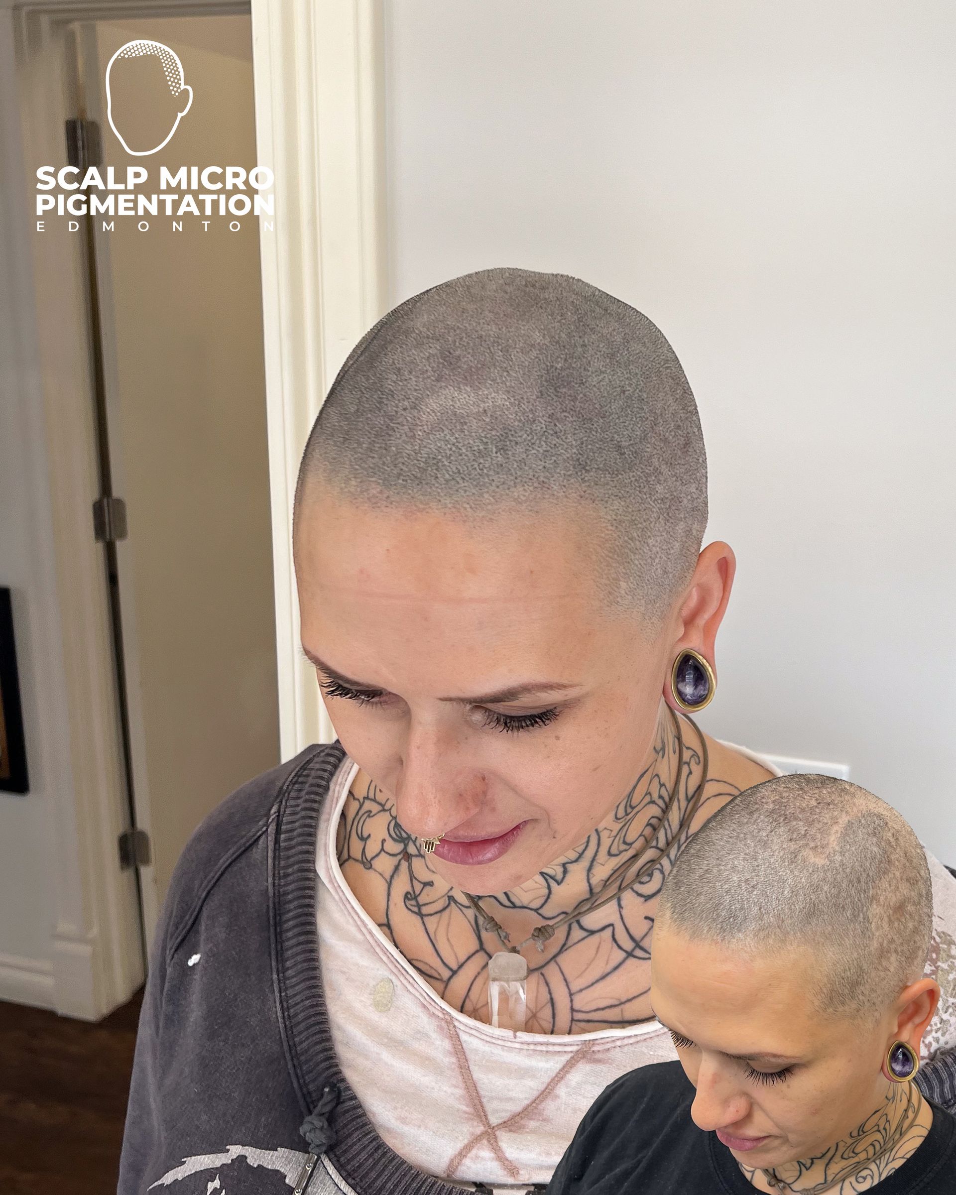 Scalp Micropigmentation Treatments | SMP Edmonton