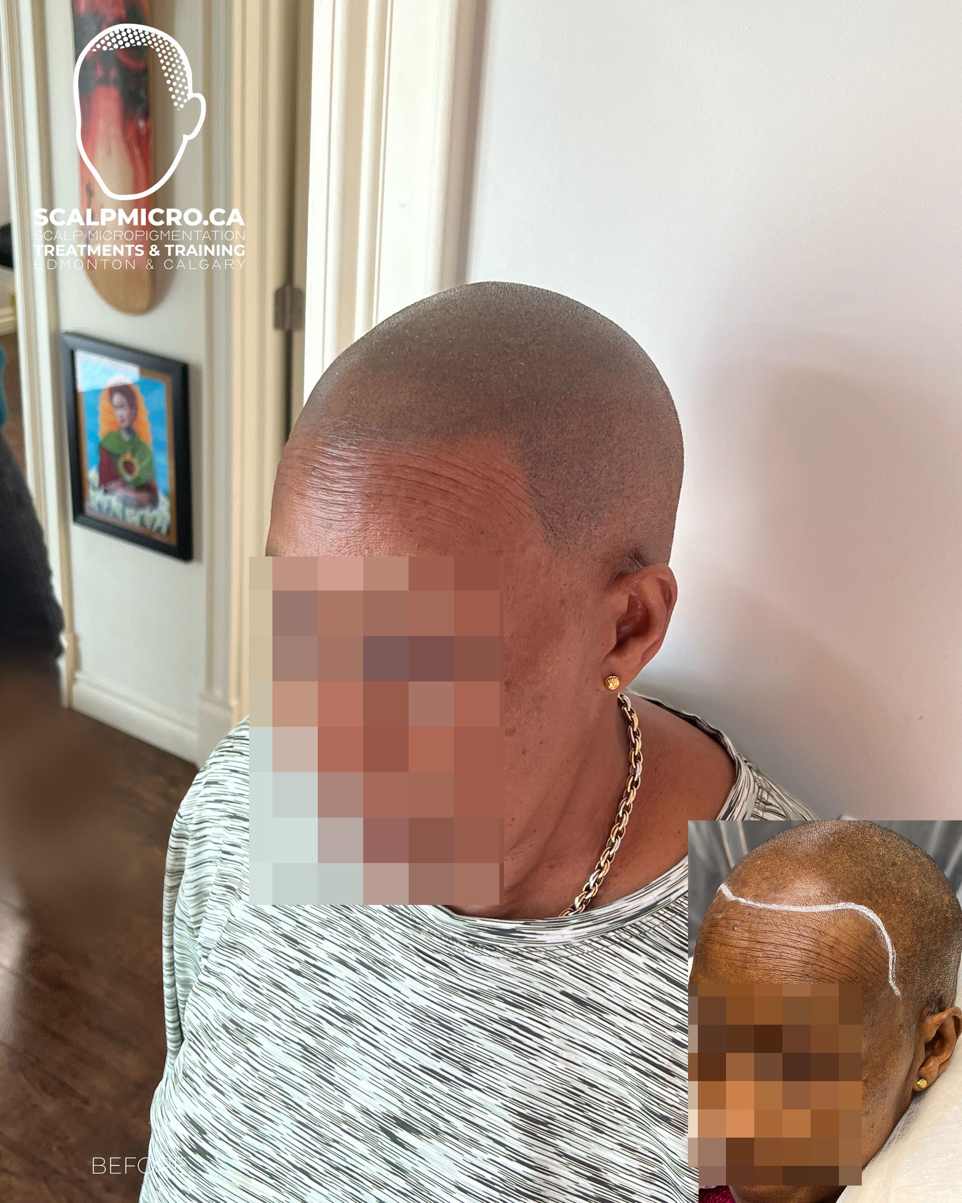 Scalp Micropigmentation Treatments | SMP Edmonton