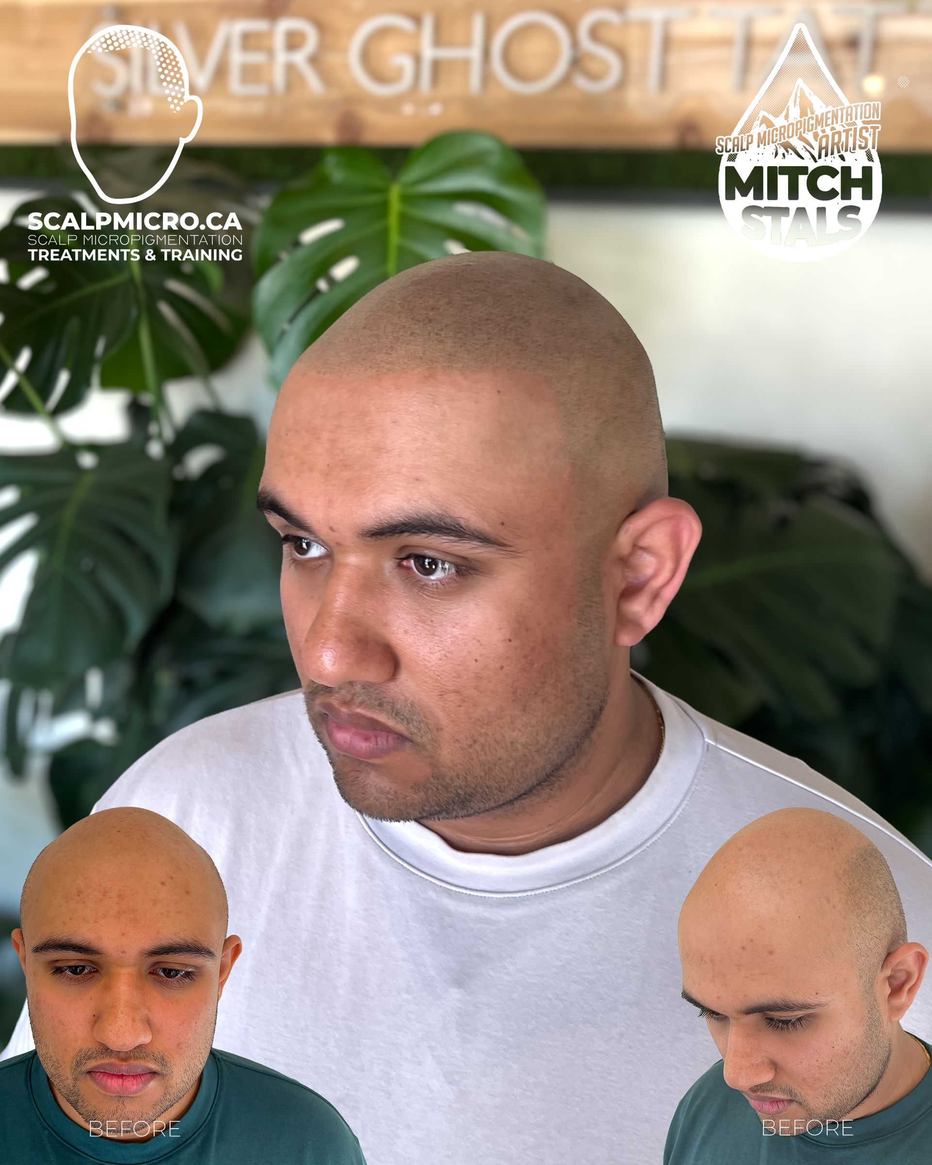 Understanding Scalp Micropigmentation (SMP) and Determining If It's ...