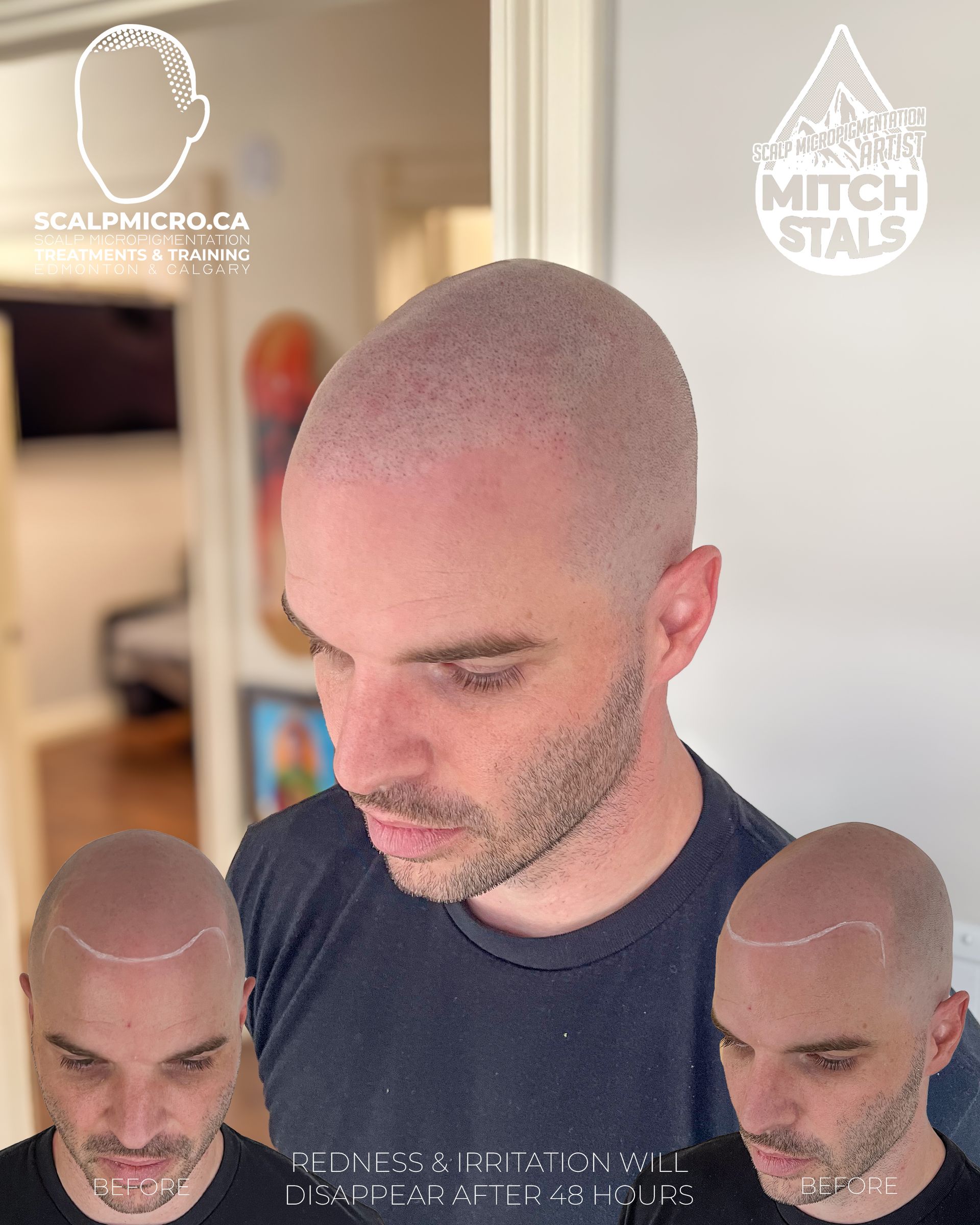 Thinking About Scalp Micropigmentation in Edmonton? Here’s What You ...
