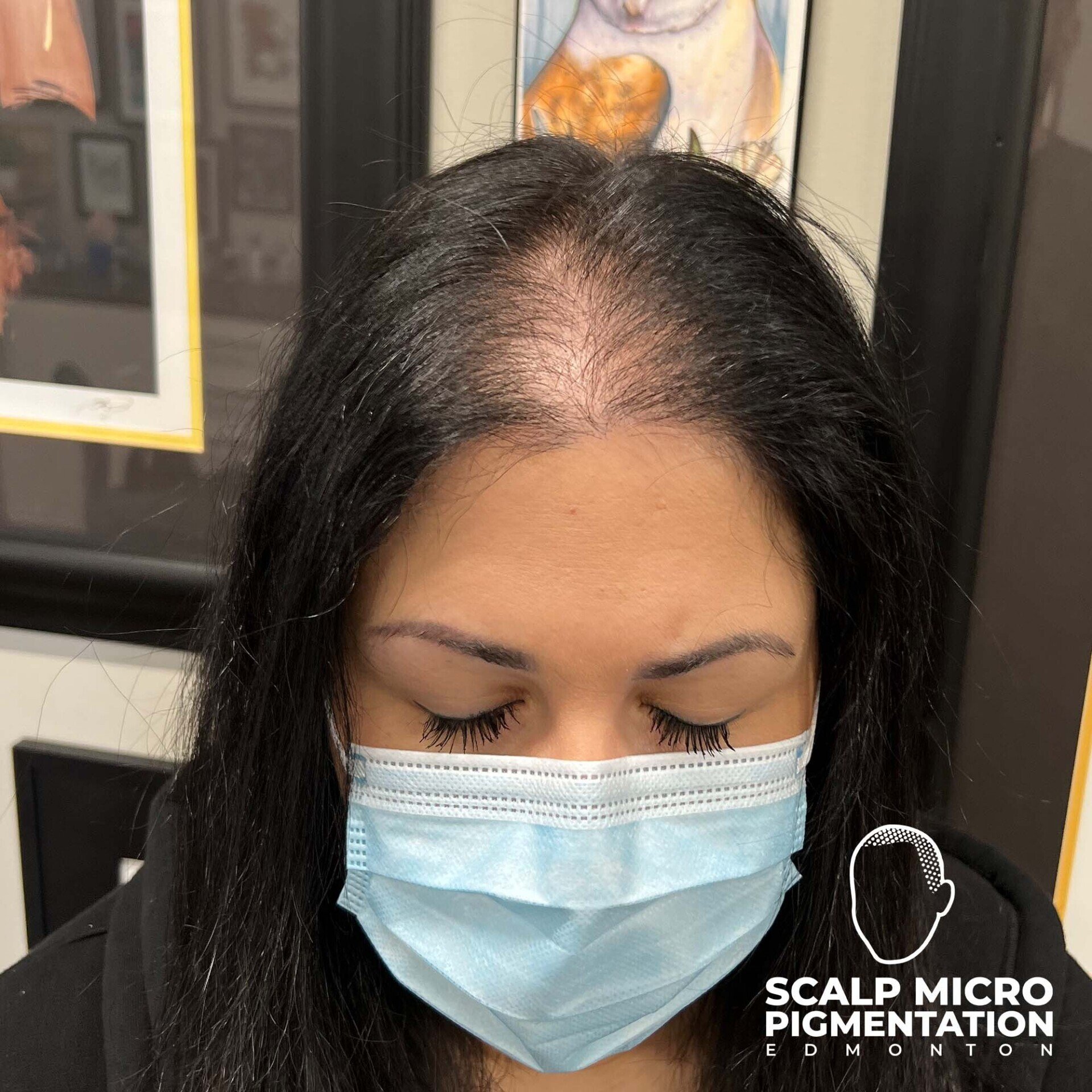 Female Scalp Micropigmentation Client Before & After Results