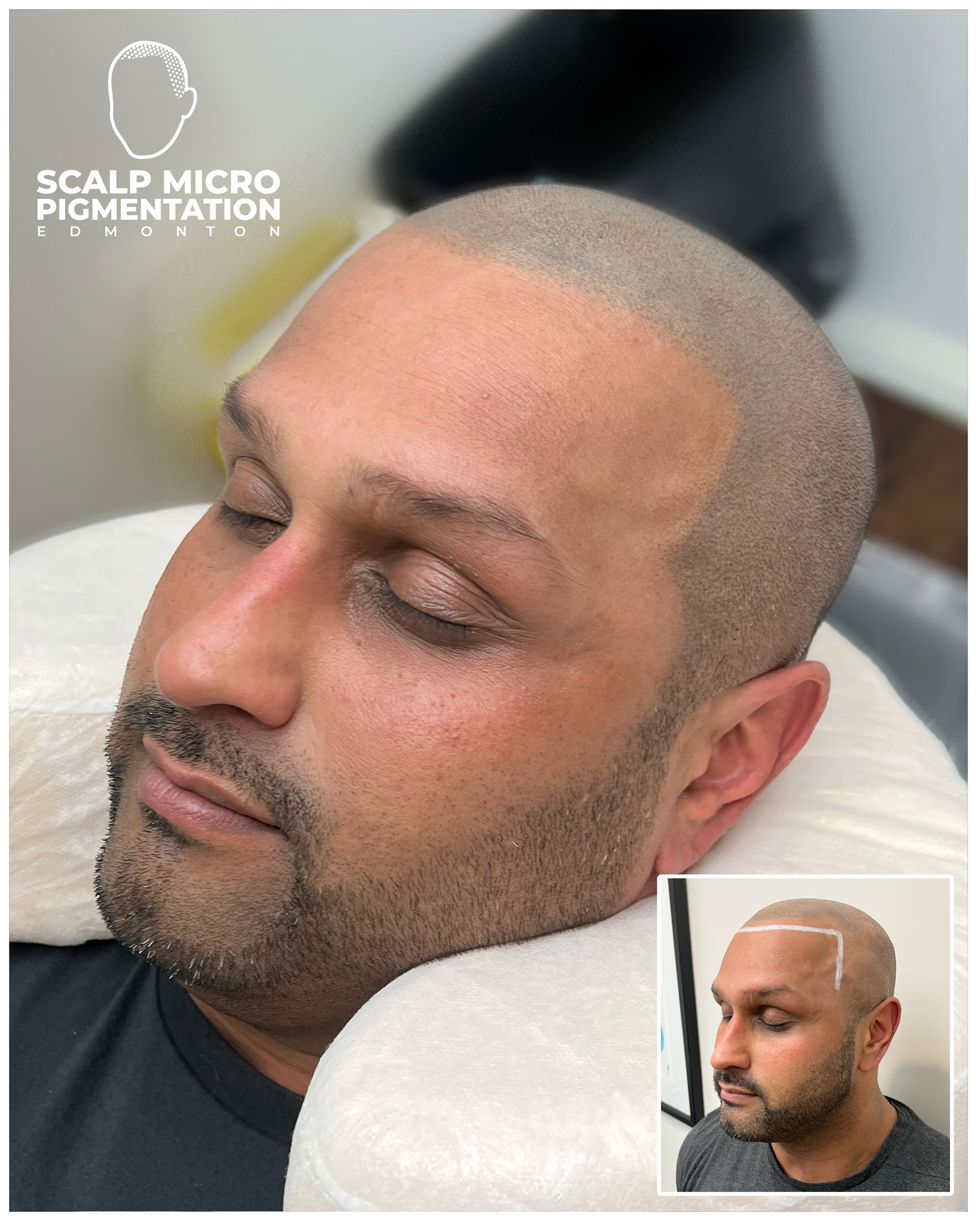 Before and After SMP Scalp micropigmentation
