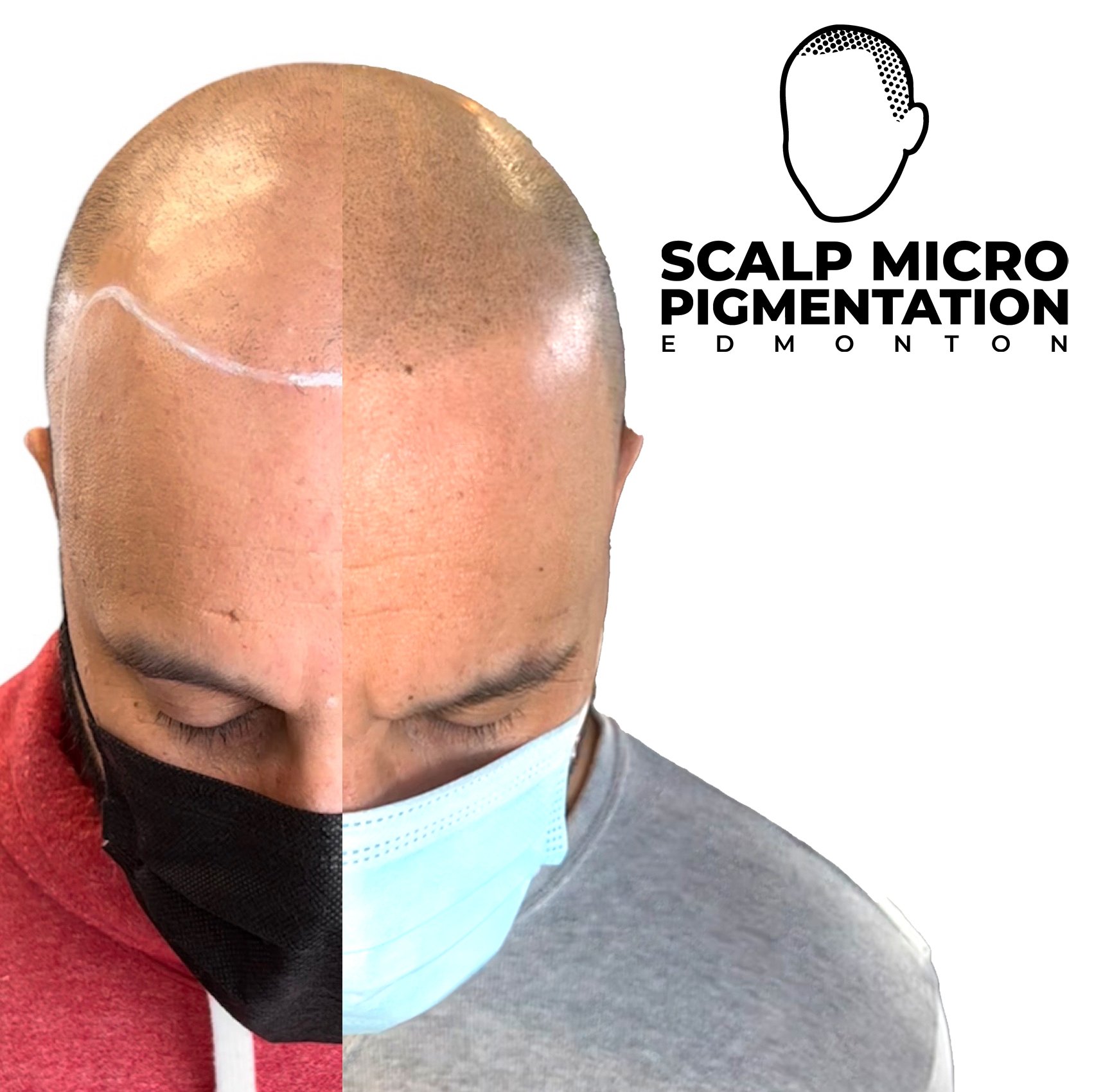 Scalp Micro Pigmentation Edmonton SMP - Bye Bye Bald and Thinning Hair