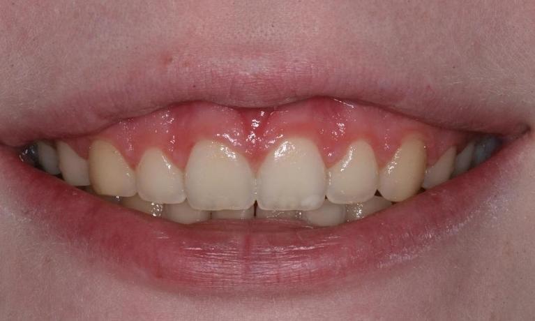 Smile Gallery | Invisalign® | Atlantis Dental Care