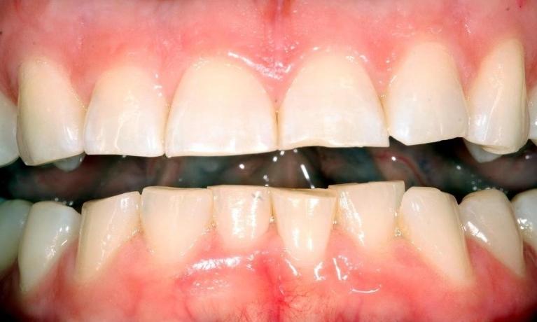 Smile Gallery | Teeth Whitening - Atlantis Dental Care