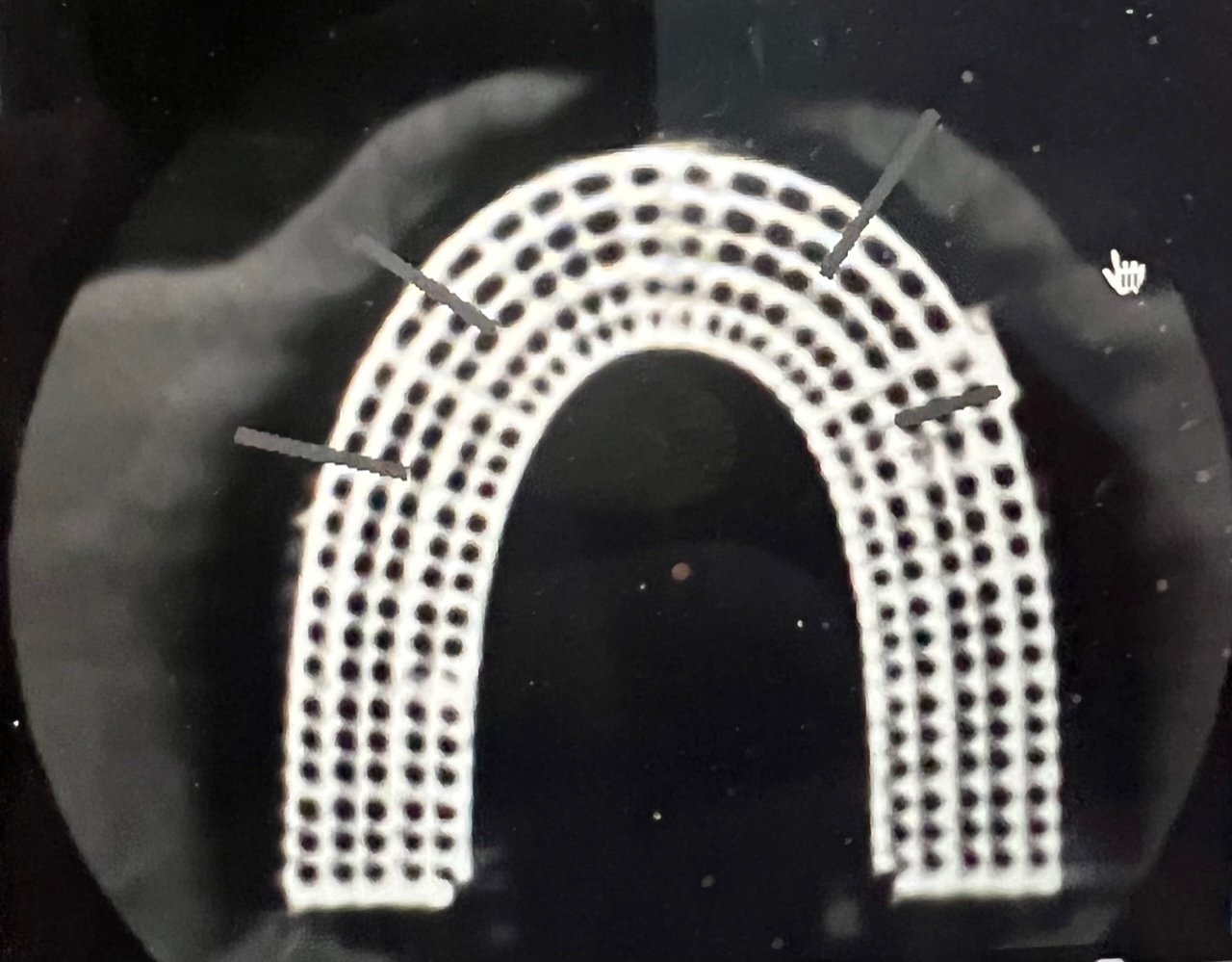 Polaris Smart Implant Guide© - Le guide chirurgical révolutionnaire