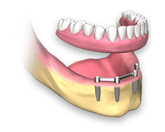 Implants denture Lethbridge | Hosack Denture Clinic