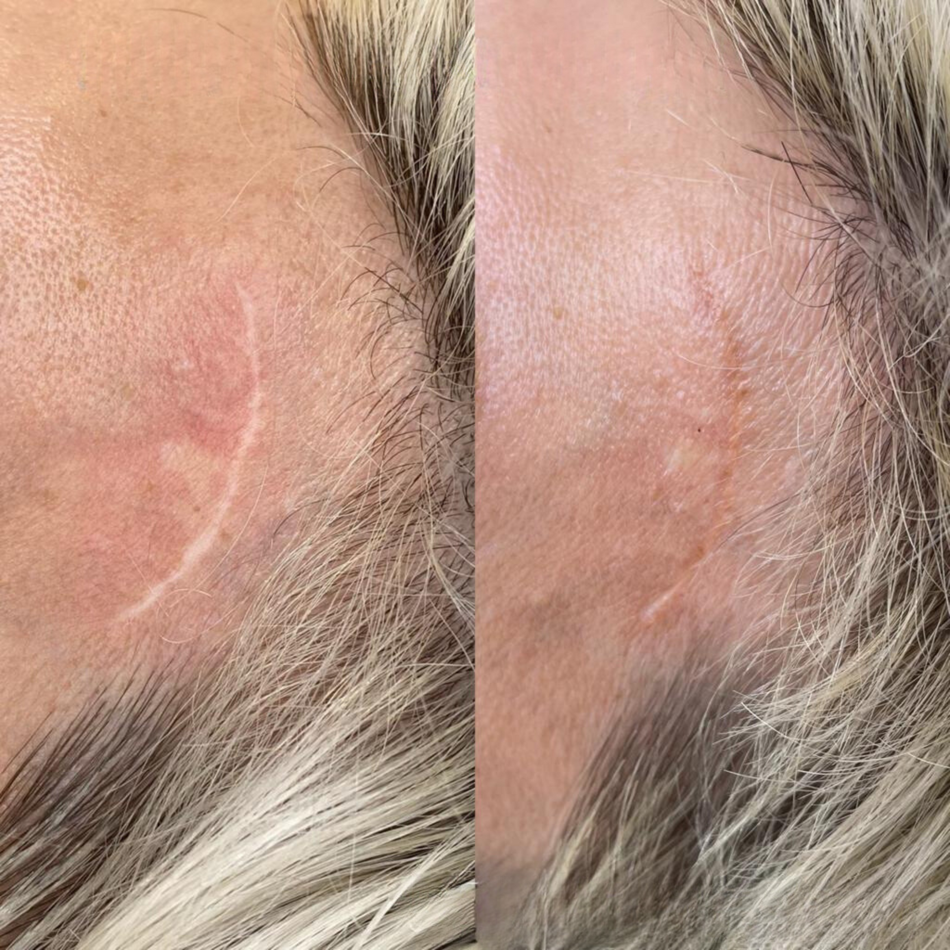 Scar Camouflage Tattoo Gold Coast | Sibina