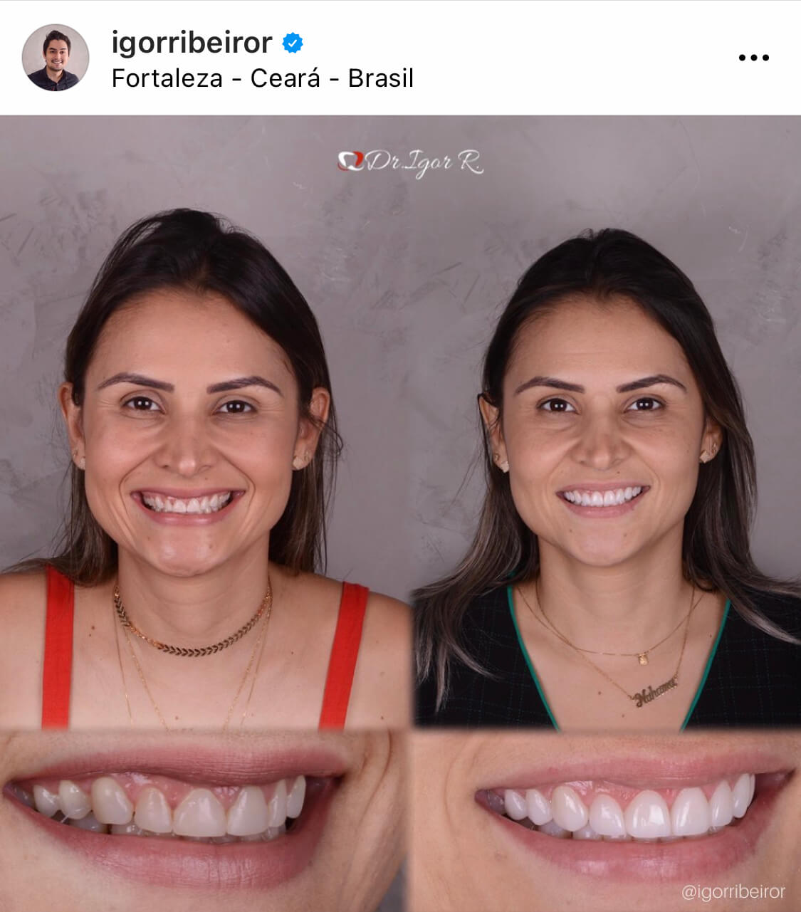 Antes e Depois | Resultados de tratamentos odontologia estética e HF