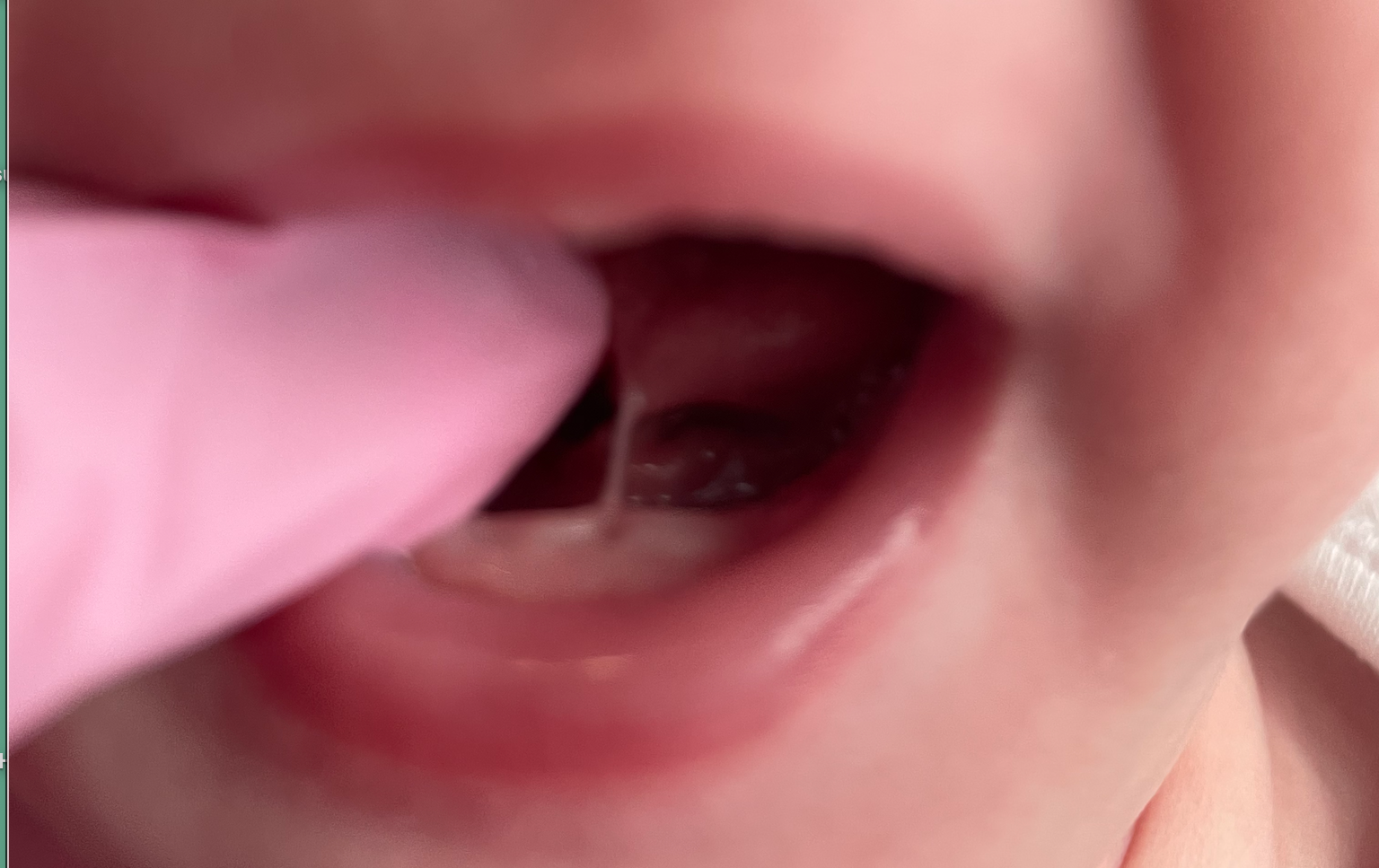 Gallery | Association of Tongue-tie Practitioners