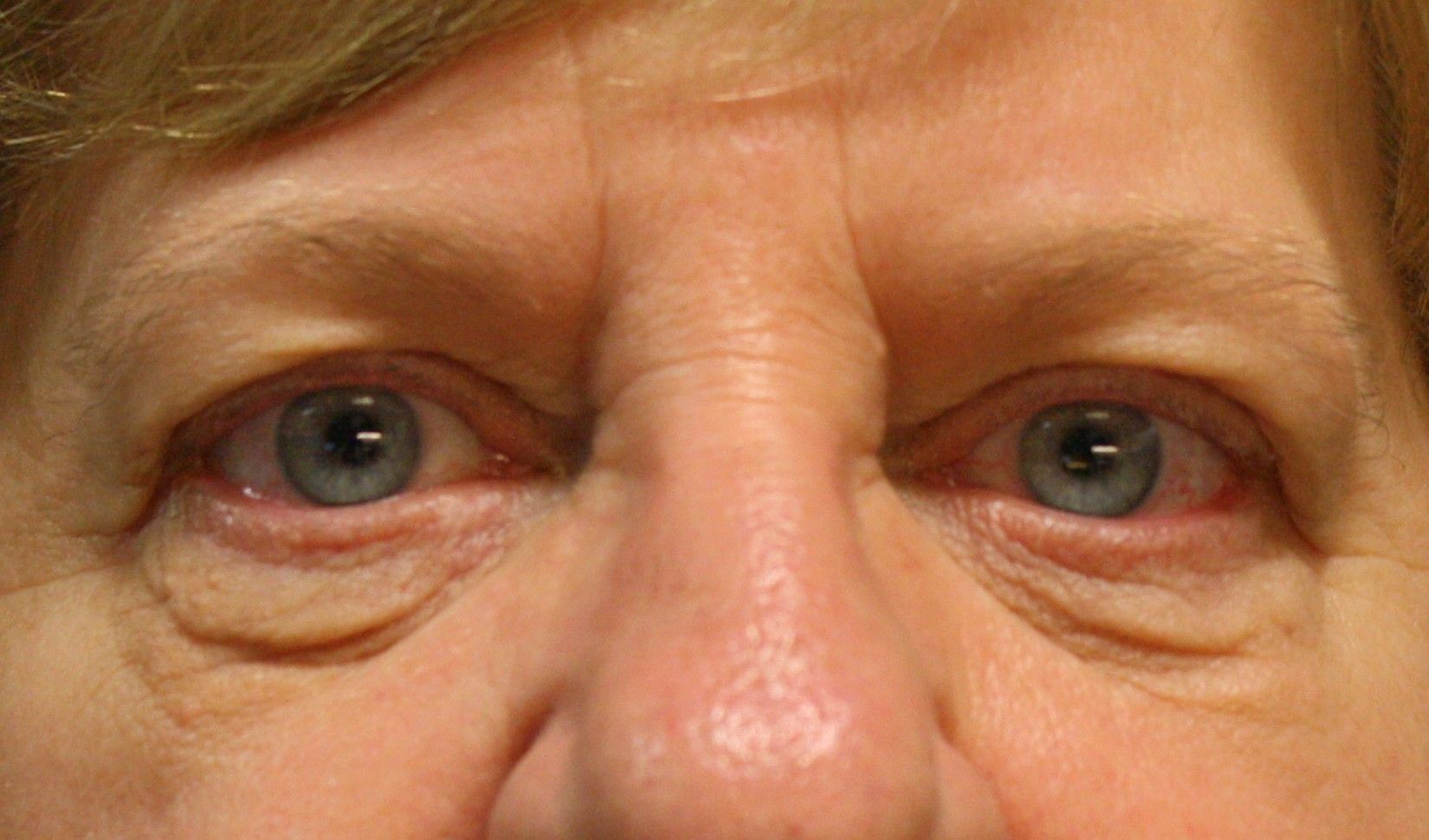 Chirurgie des Paupières Inférieures Avant et Aprés | Clinique O ...