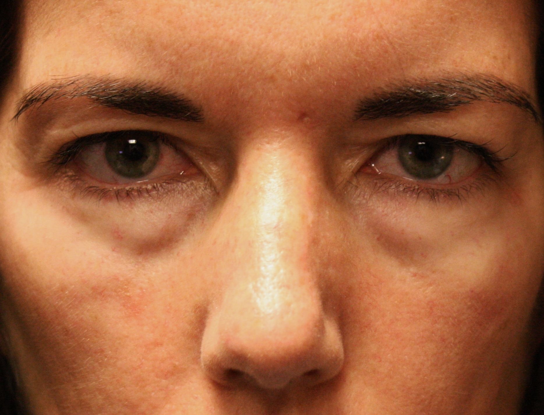 Lipo-Transfert | Clinique O - Chirurgie Plastique et Esthétique de l'oeil