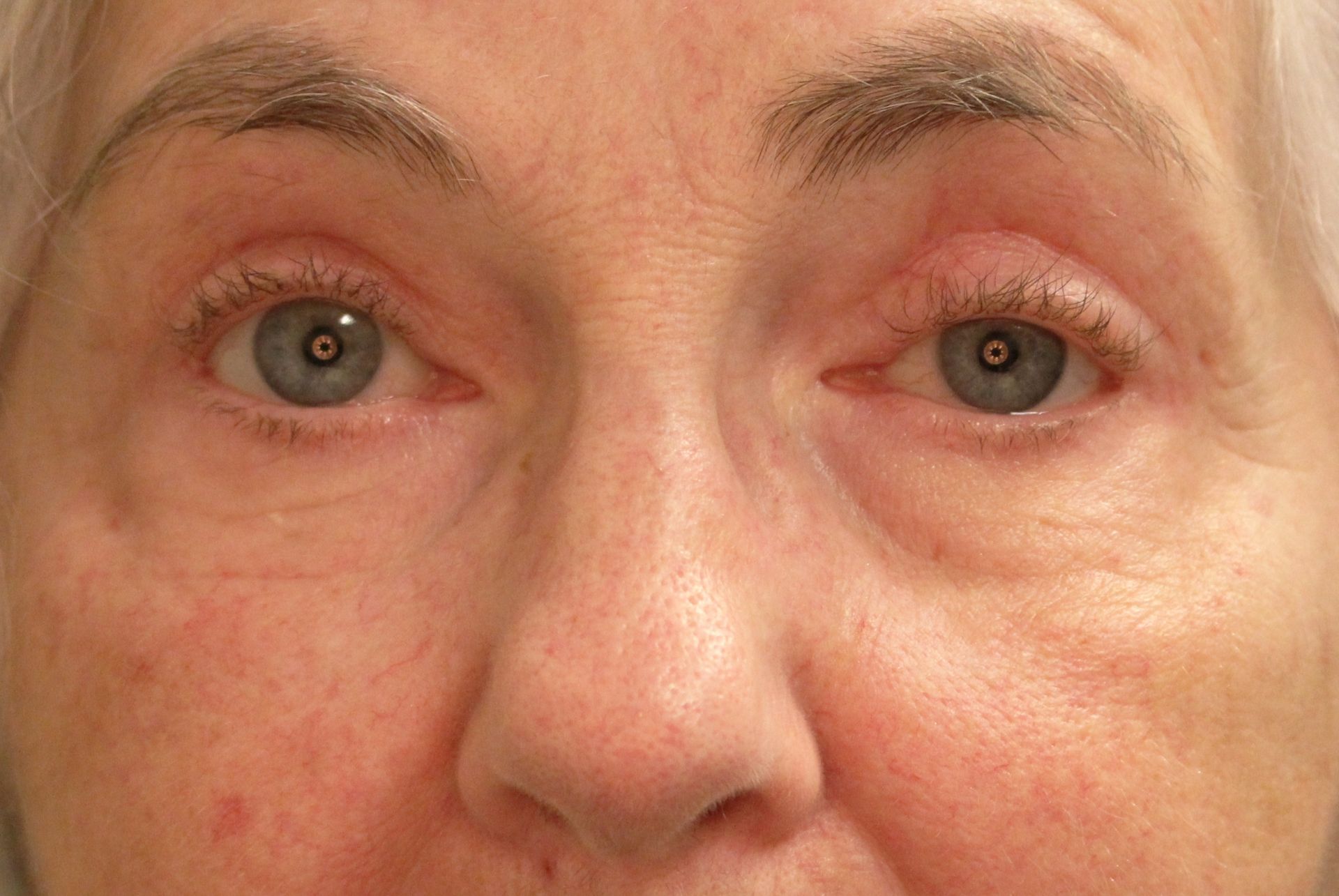 Clinique O | Chirurgie des Paupières Supérieures Avant et Aprés