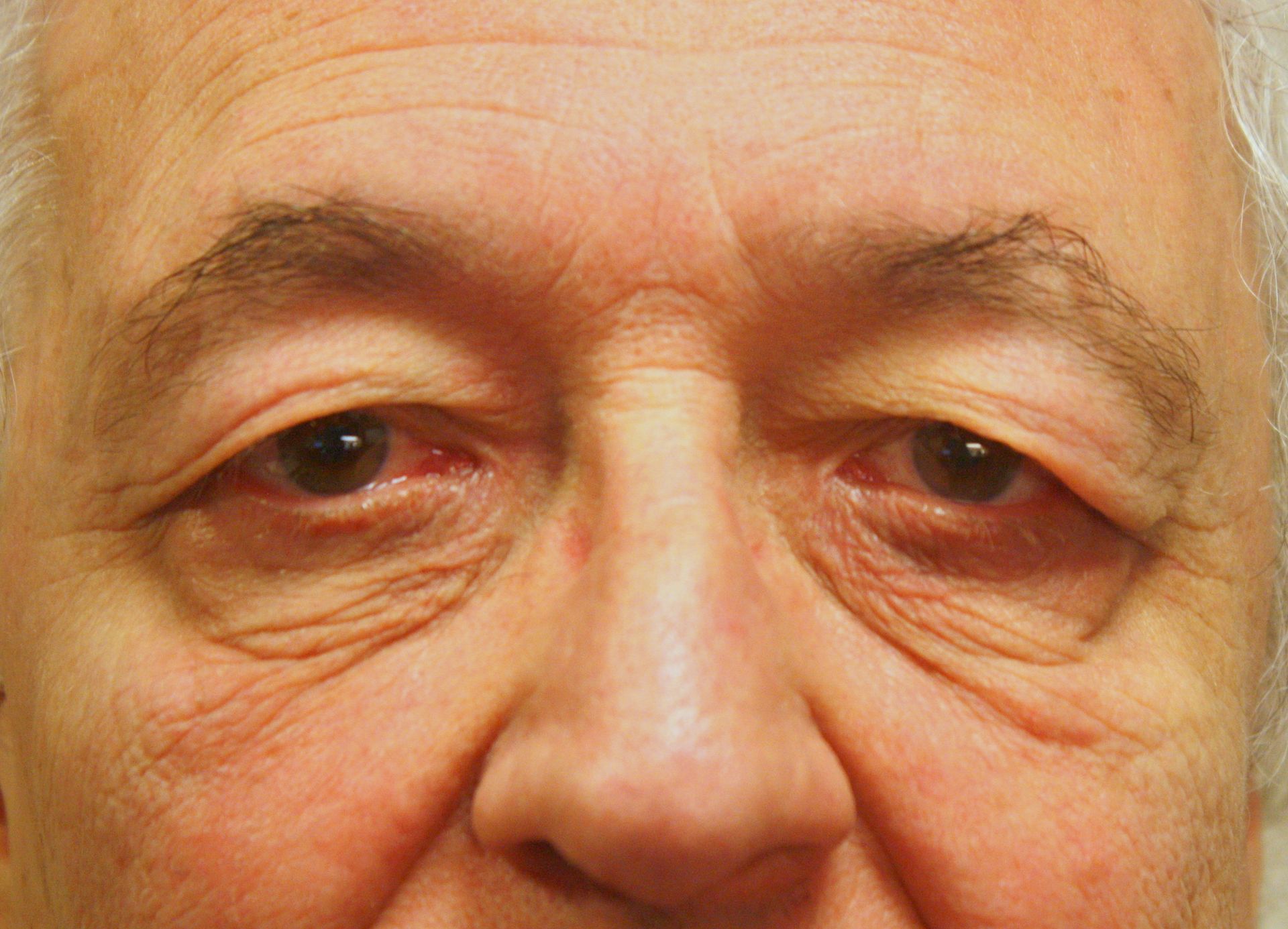 Clinique O | Chirurgie des Paupières Supérieures Avant et Aprés