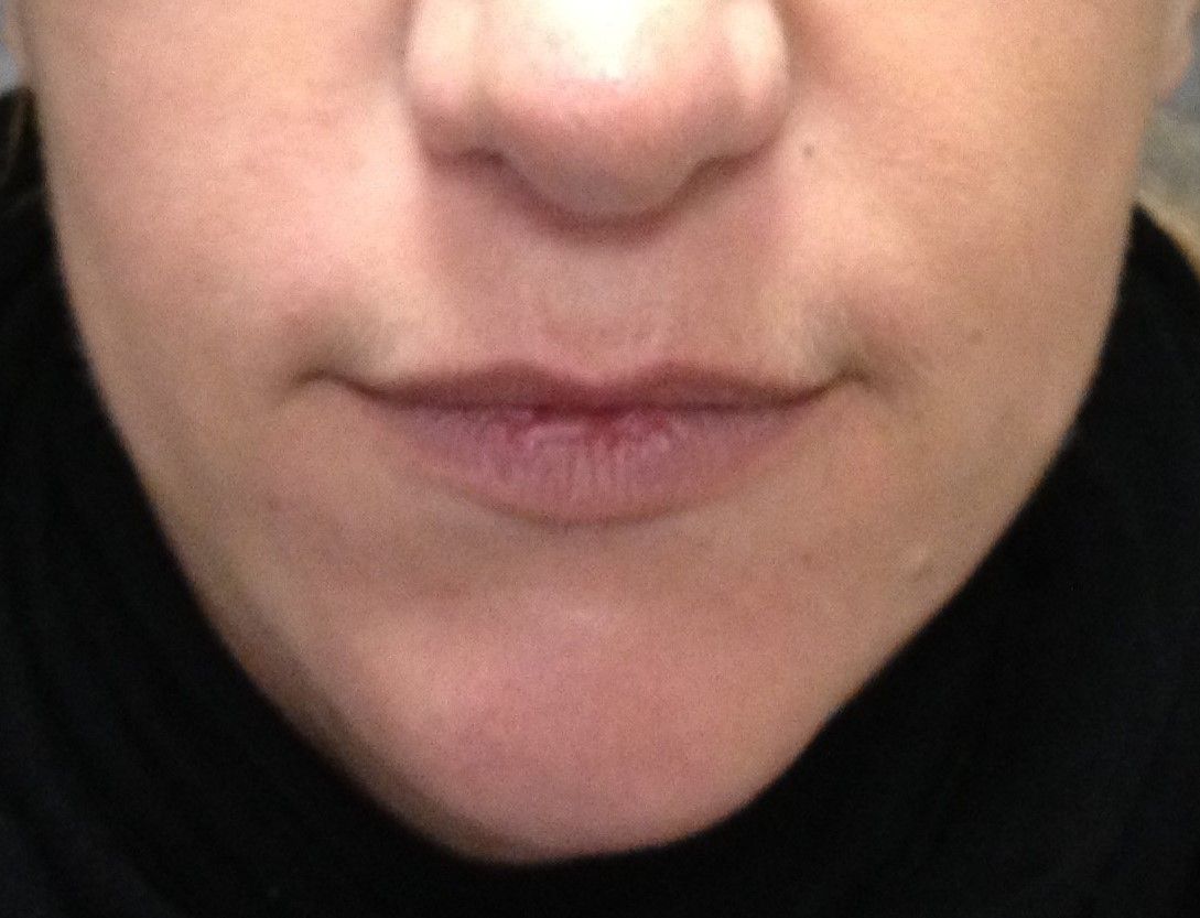 Soins esthétiques de la Machoire | Clinique O