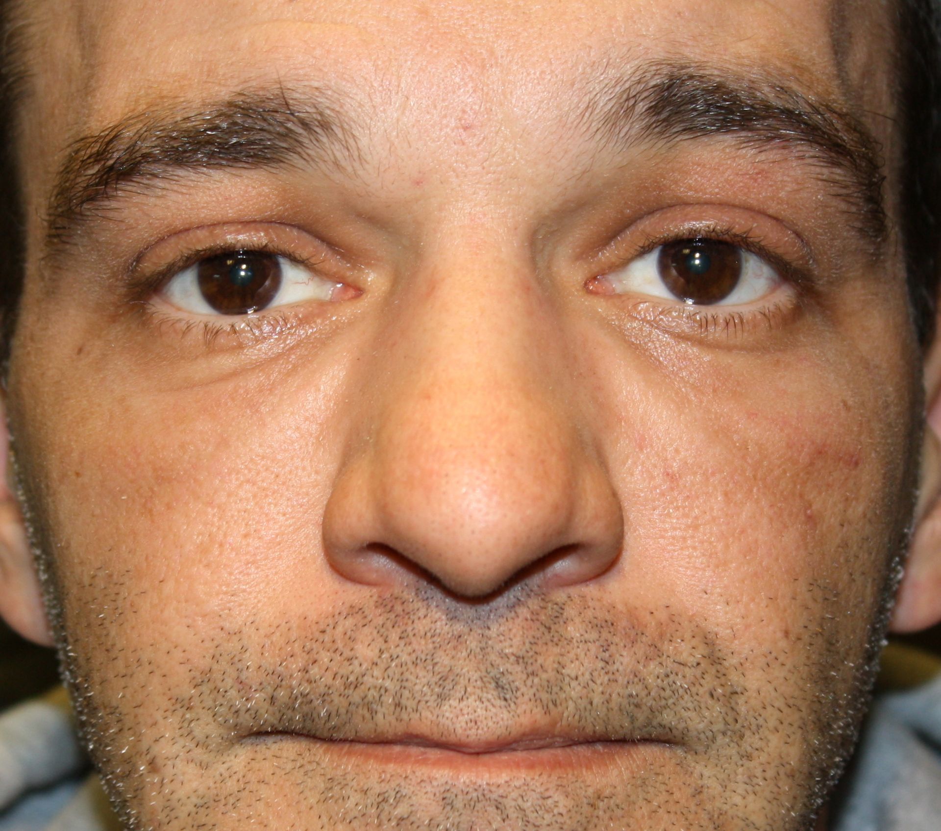 Chirurgie esthétique des joues | Cliniique O