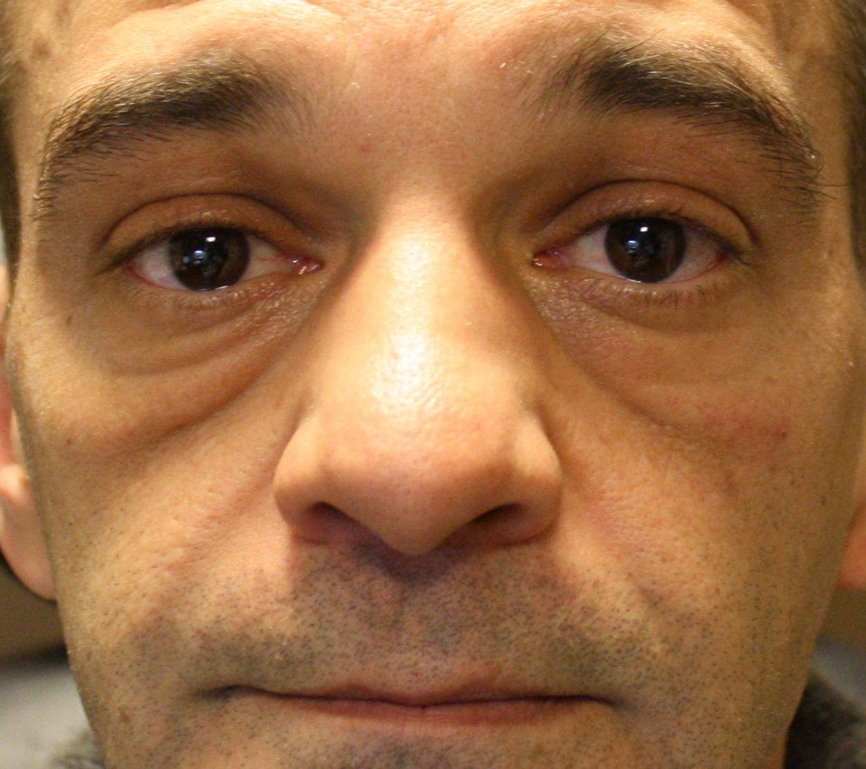 Chirurgie esthétique des joues | Cliniique O