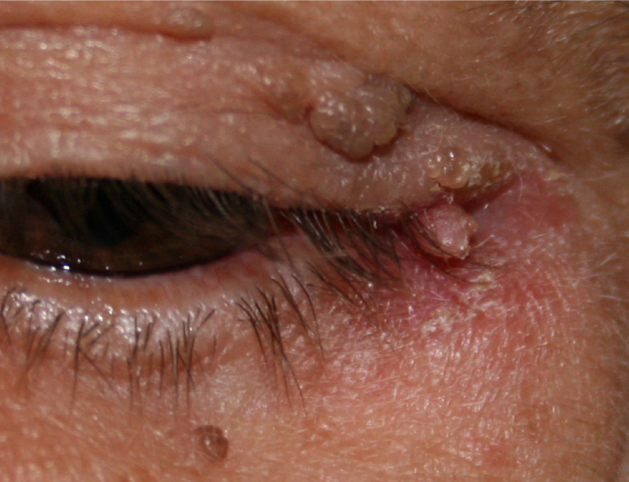 Acrochordons | Traitement excroissances cutanées | Clinique O