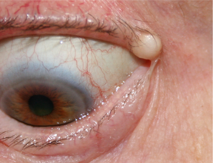 Traitement des Kystes avec la Clinique O | Clinique O Montreal