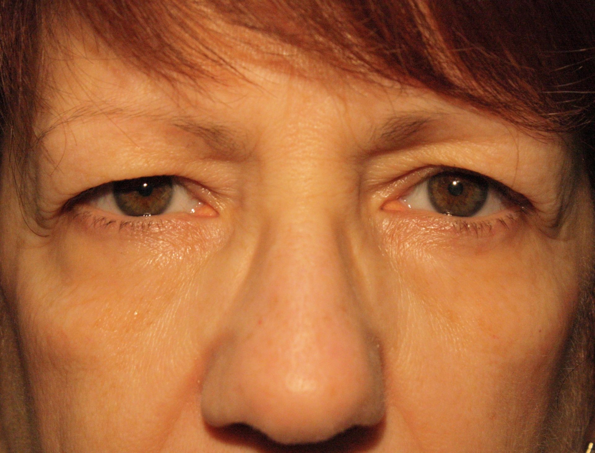 Clinique O | Chirurgie des Paupières Supérieures Avant et Aprés