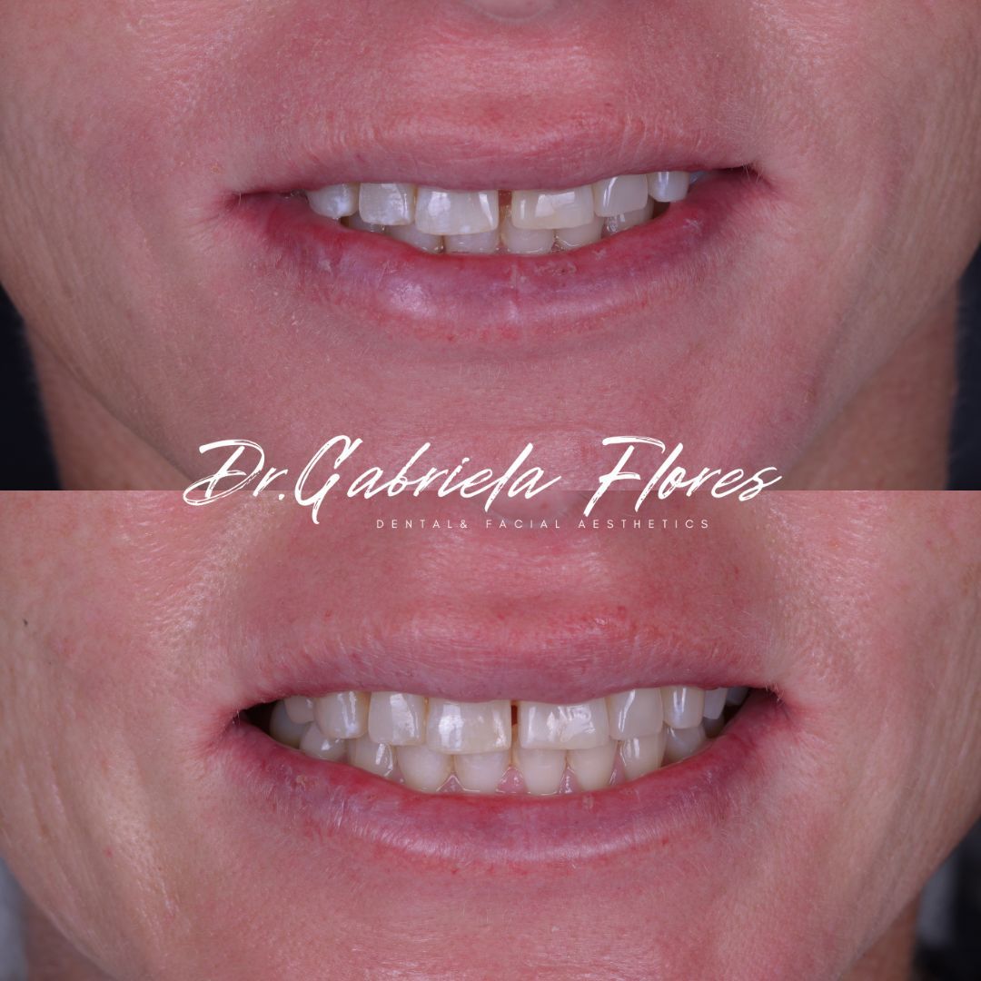 Cosmetic Dentistry in Miami Beach FL | Miami Beach Cosmetic Dentist