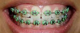 Cool Colors for Cool Smiles: Putting the Fun in Braces Treatment