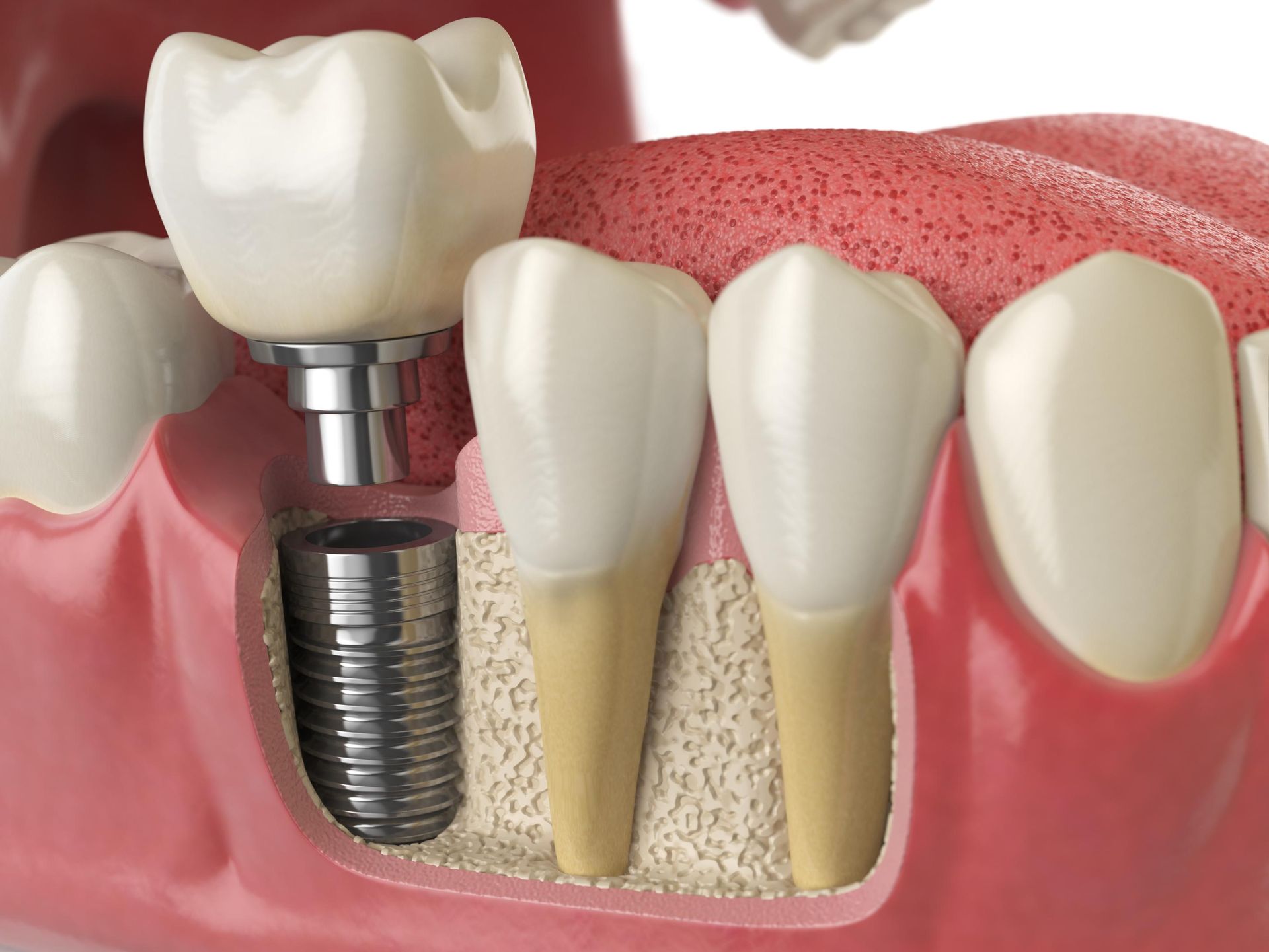Comprehensive Guide to Molar Tooth Implants | Casa Adobes