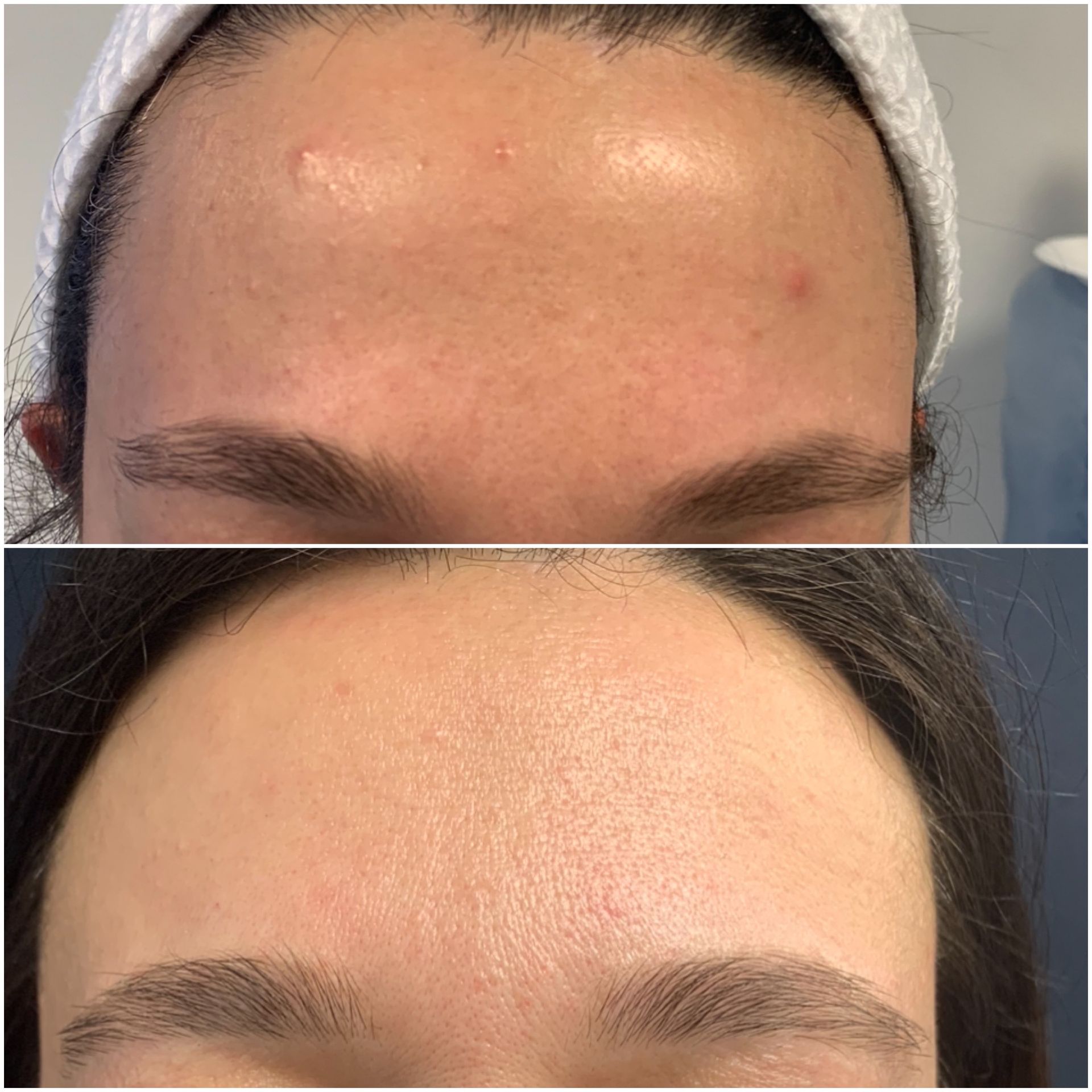 Acne Treatments | Results Skincare & Massage Studio | Fort Myers