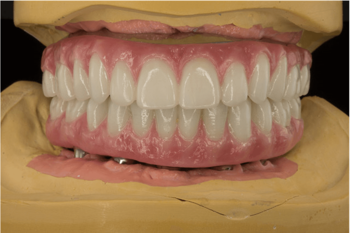 360 IPRO | Hershberger Dental Lab