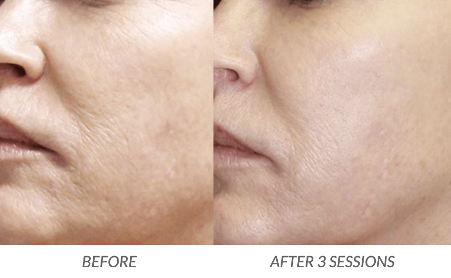 DermaSweep | Moodz Salon & Spa | Acton, MA & Wayland, MA