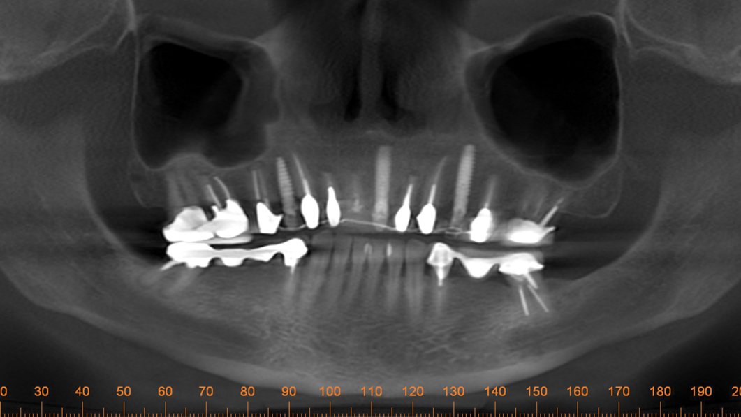 Atraumatic Extraction Technique