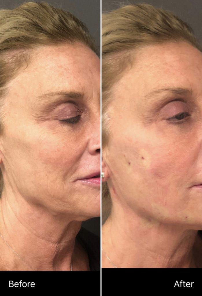 Silhouetter Instalift Threads | TIme 4 U Med Spa Before & Afters