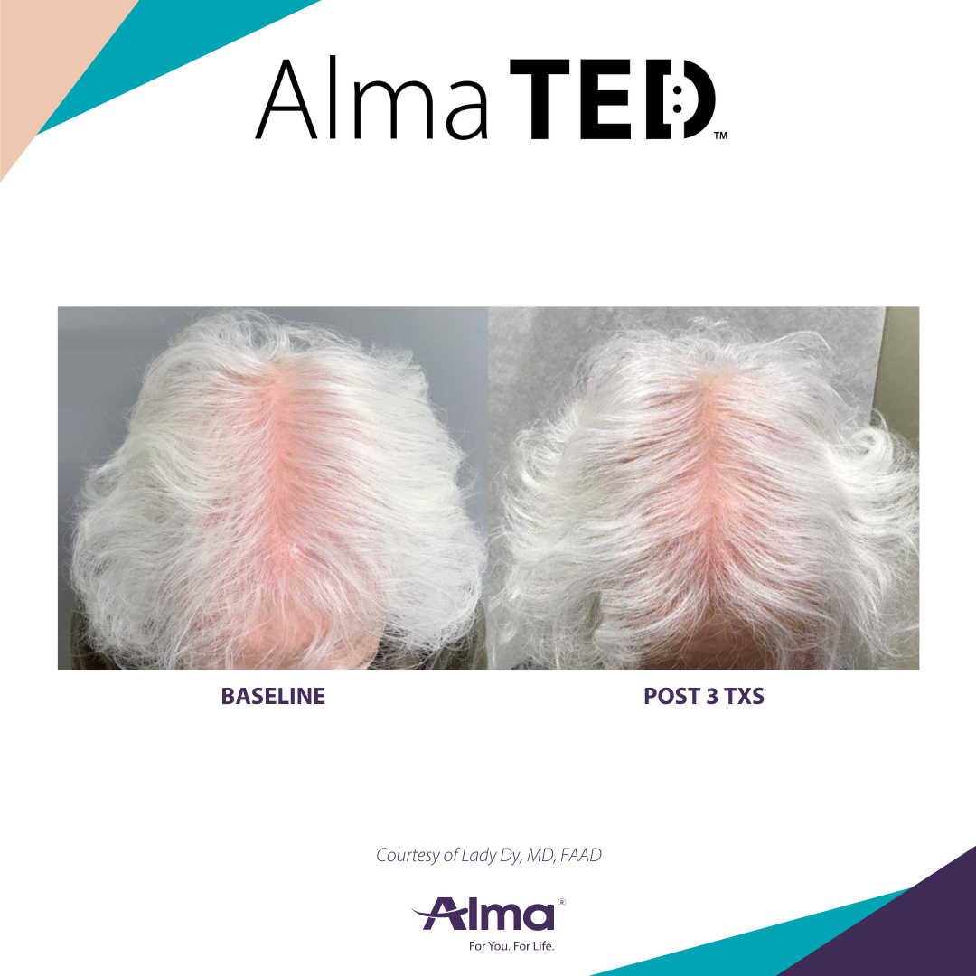 Hair Growth Treatment with Alma Ted® | VIP Primary Health Care