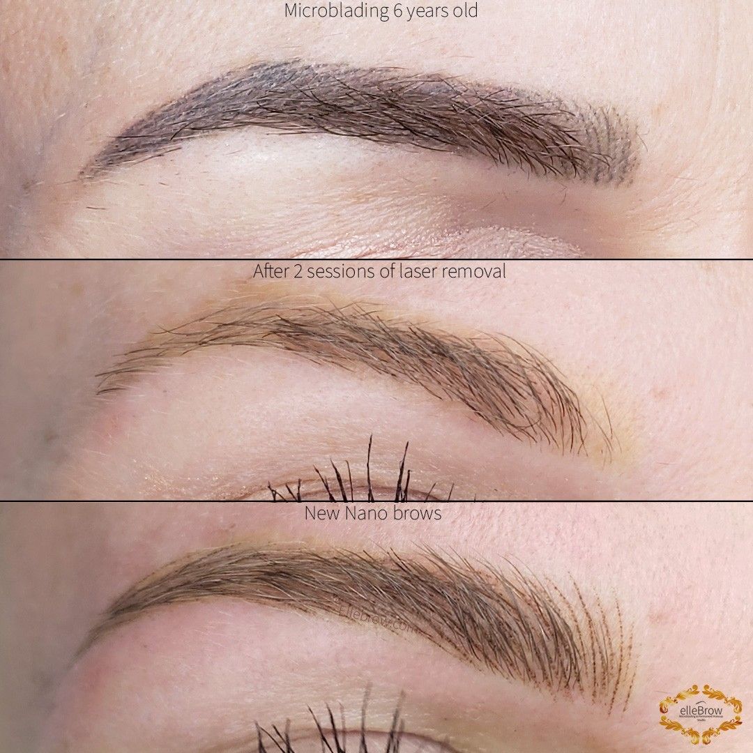 Do You Need Microblading Laser Removal Before Nano Brows? | Ellebrow NYC