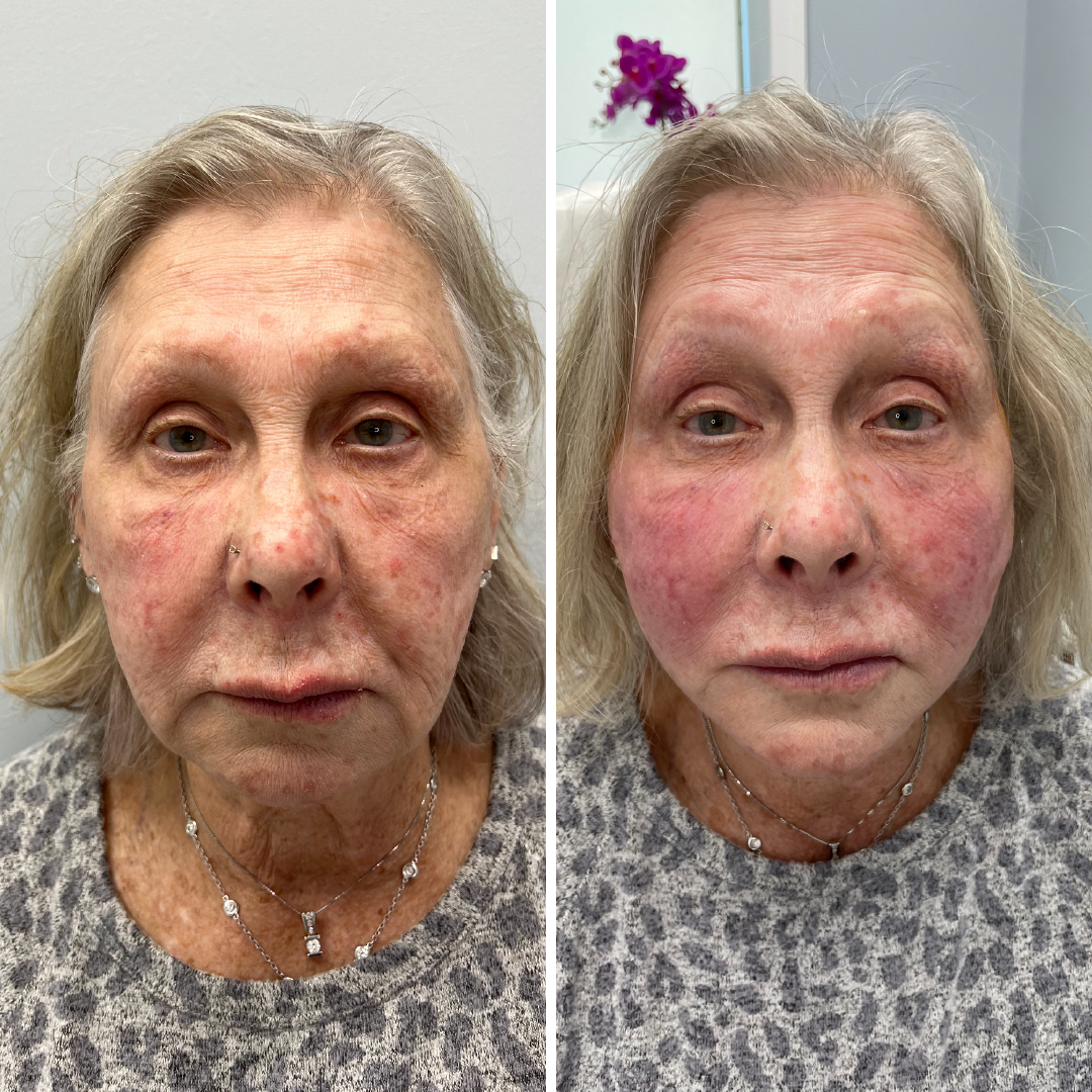 PDO Threads in Dearborn, Michigan - SKIN MD