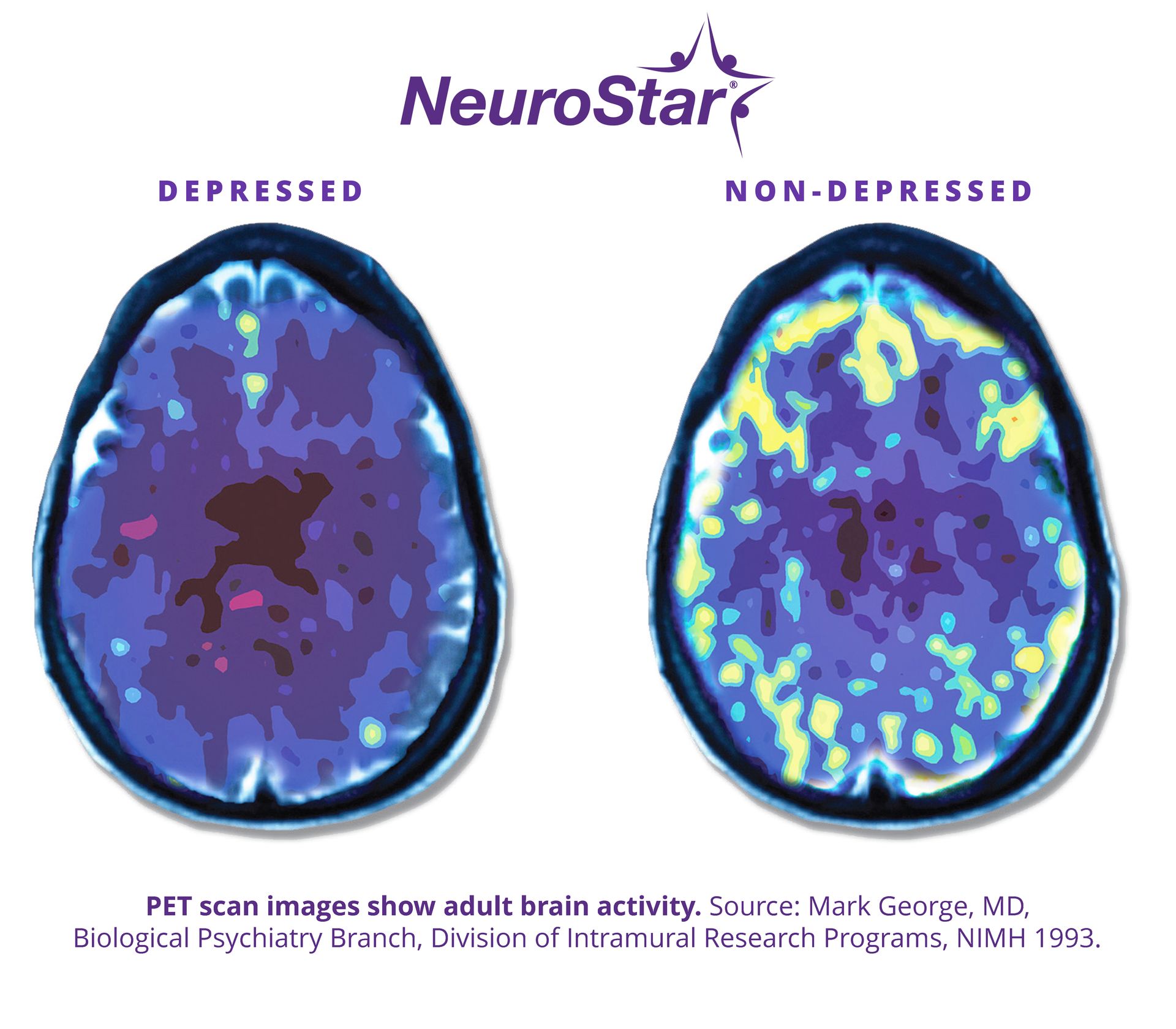 My TMS Journey: Finding Hope, Healing, and a New Beginning