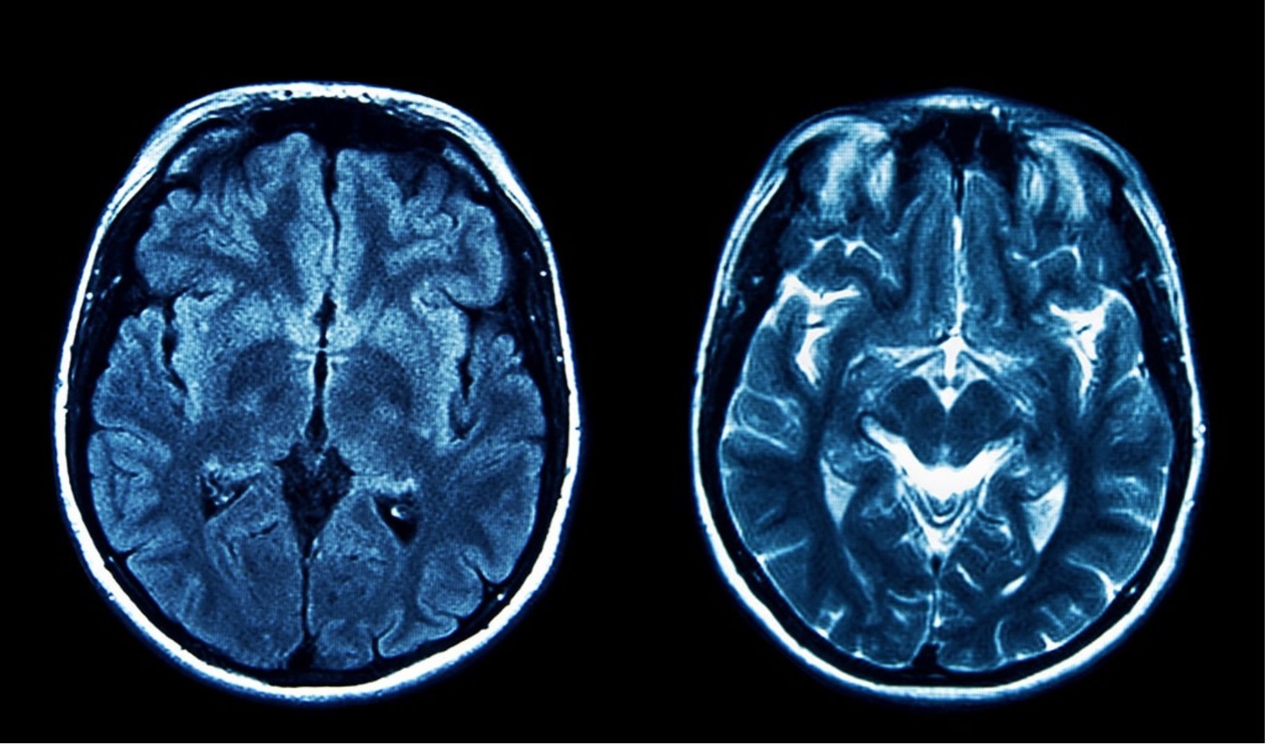 Everything You Need to Know About MRI Brain Scans: A Comprehensive Guide