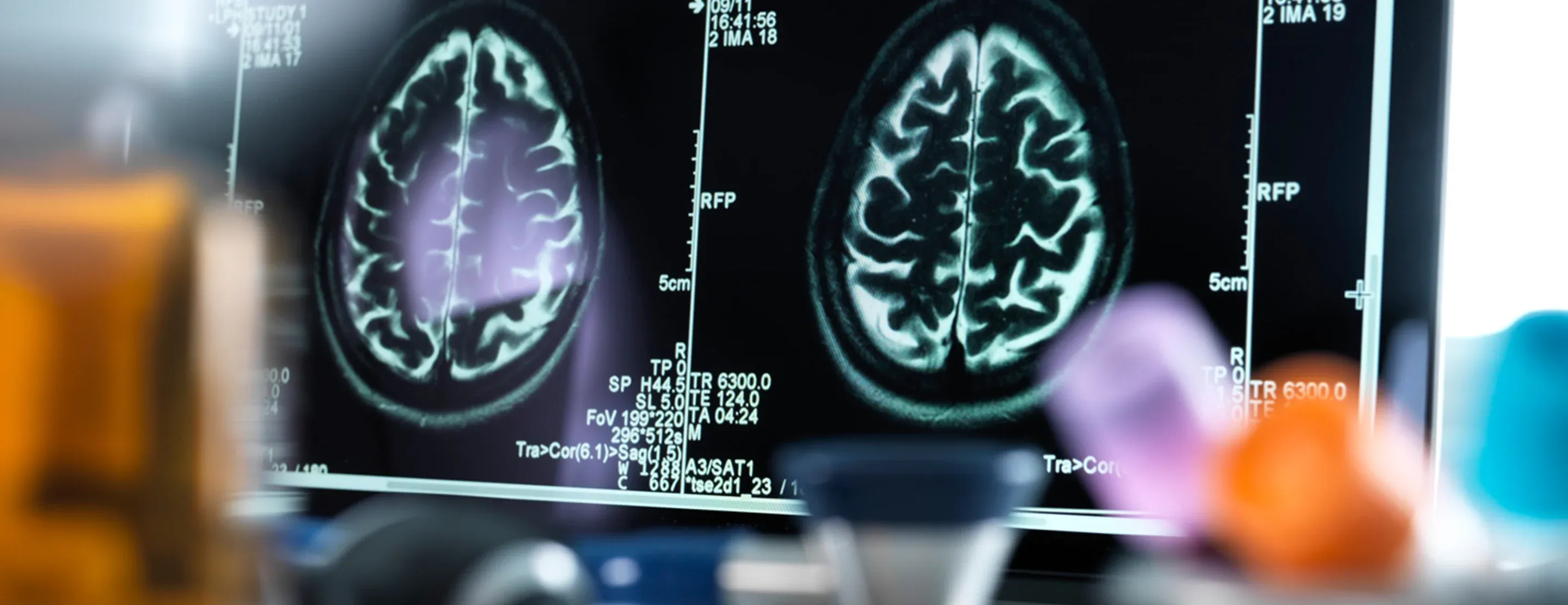 The Importance of MRI in Diagnosing Brain Conditions
